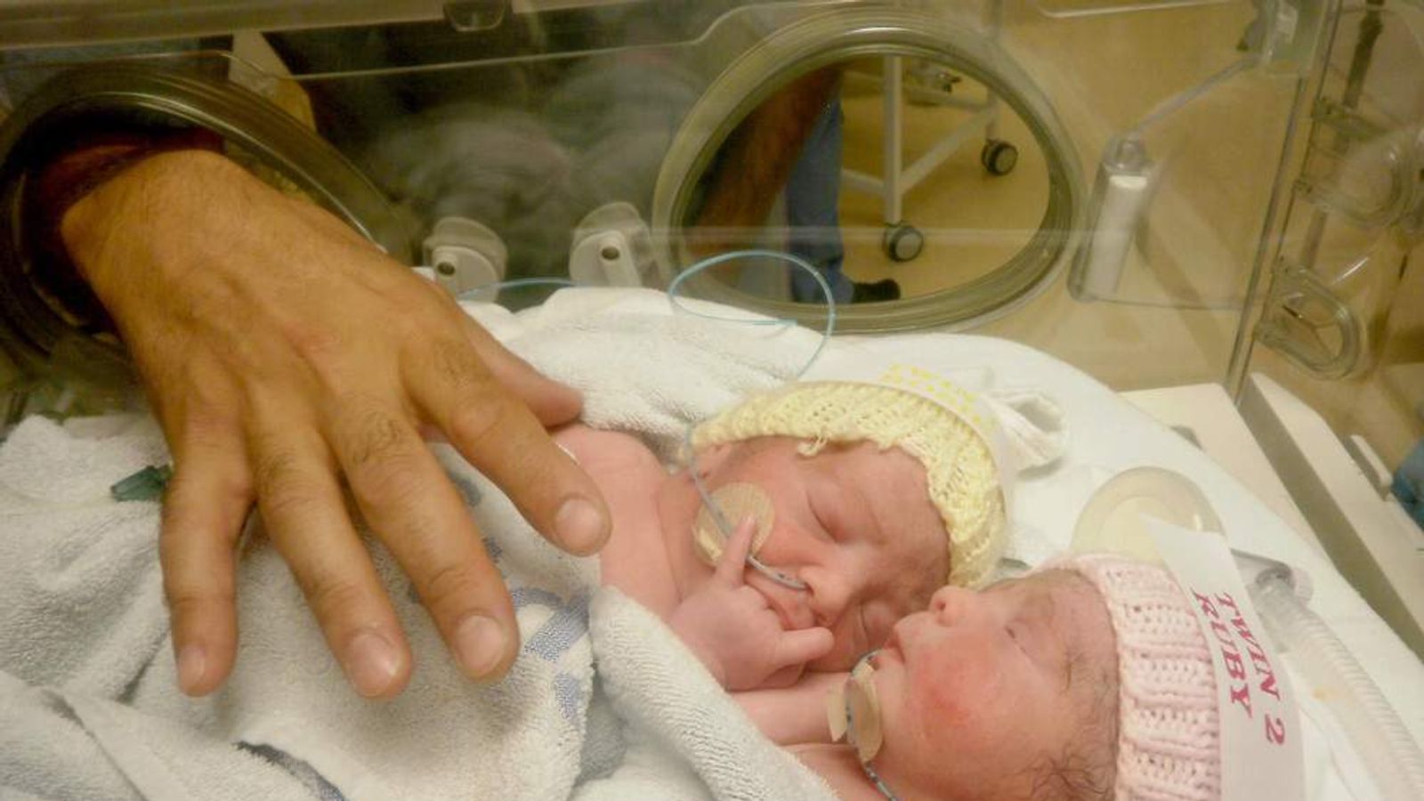 Conjoined Twins: Babies Successfully Separated | UK News | Sky News