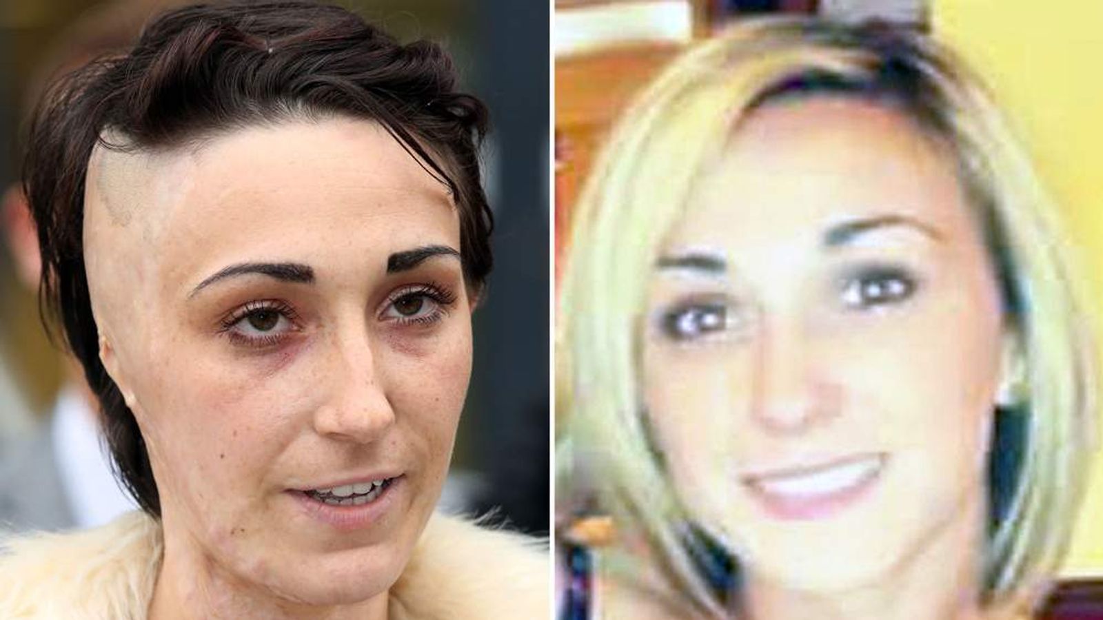 Acid Attack Victim Calls For Life Sentences | UK News | Sky News