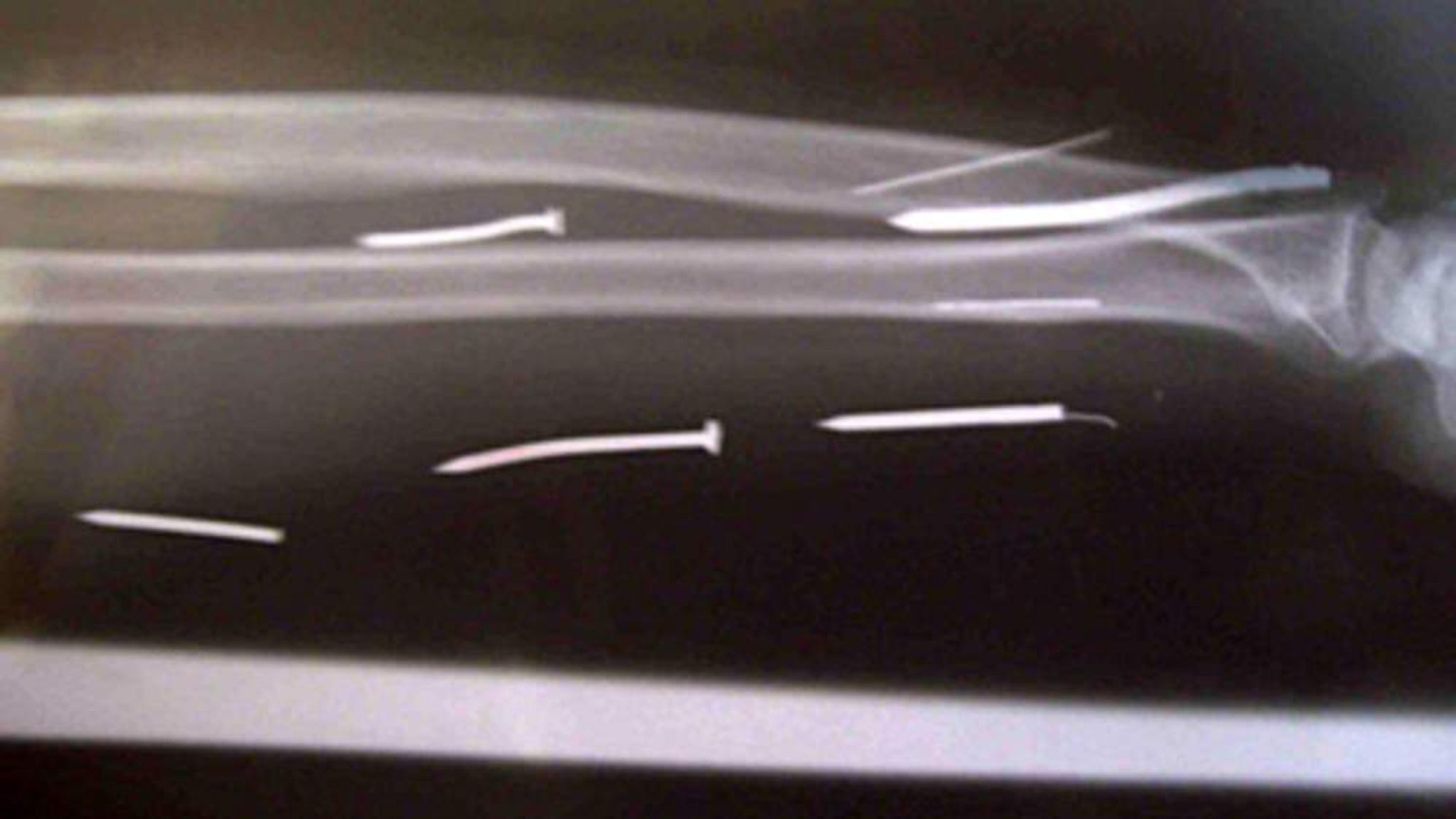 Housemaid With 24 Nails Hammered Into Body | World News | Sky News