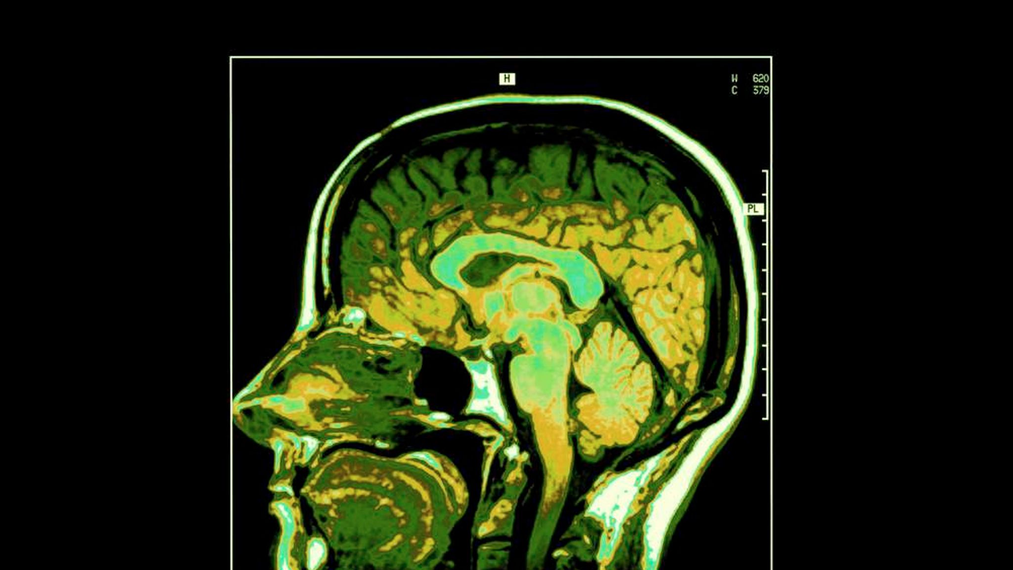 Runny Nose Turns Out To Be Leaking Brain Fluid | US News | Sky News