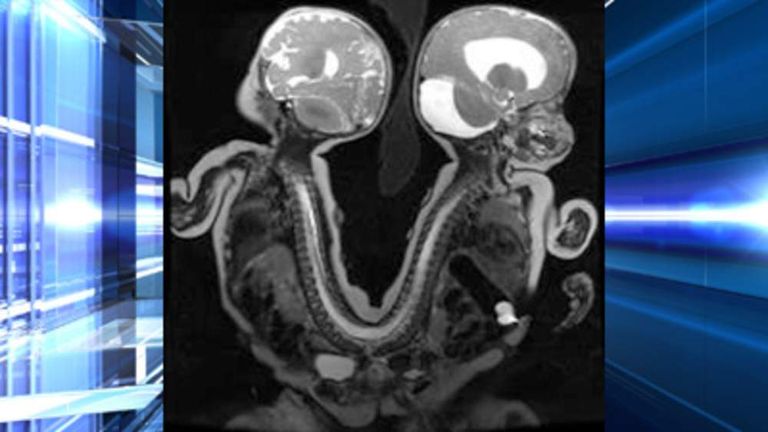 Twins Joined At Spine Separated In 13-Hour Op | World News | Sky News