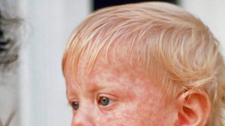 Nationwide Drive To Boost MMR Vaccination | UK News | Sky News