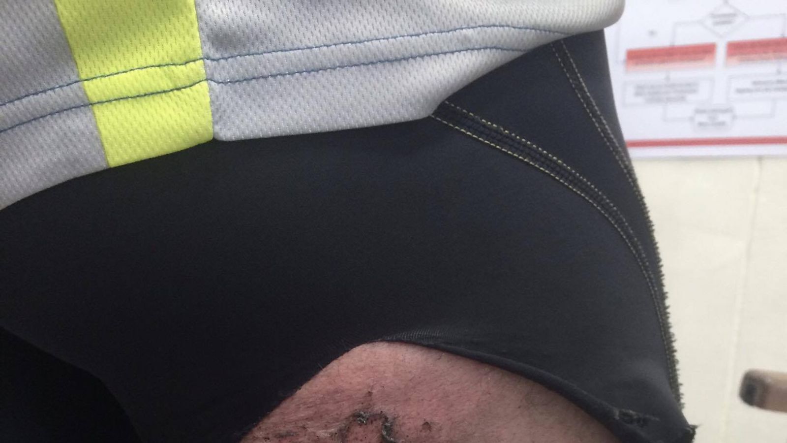 Briton Burned After iPhone Explodes In Pocket | World News | Sky News