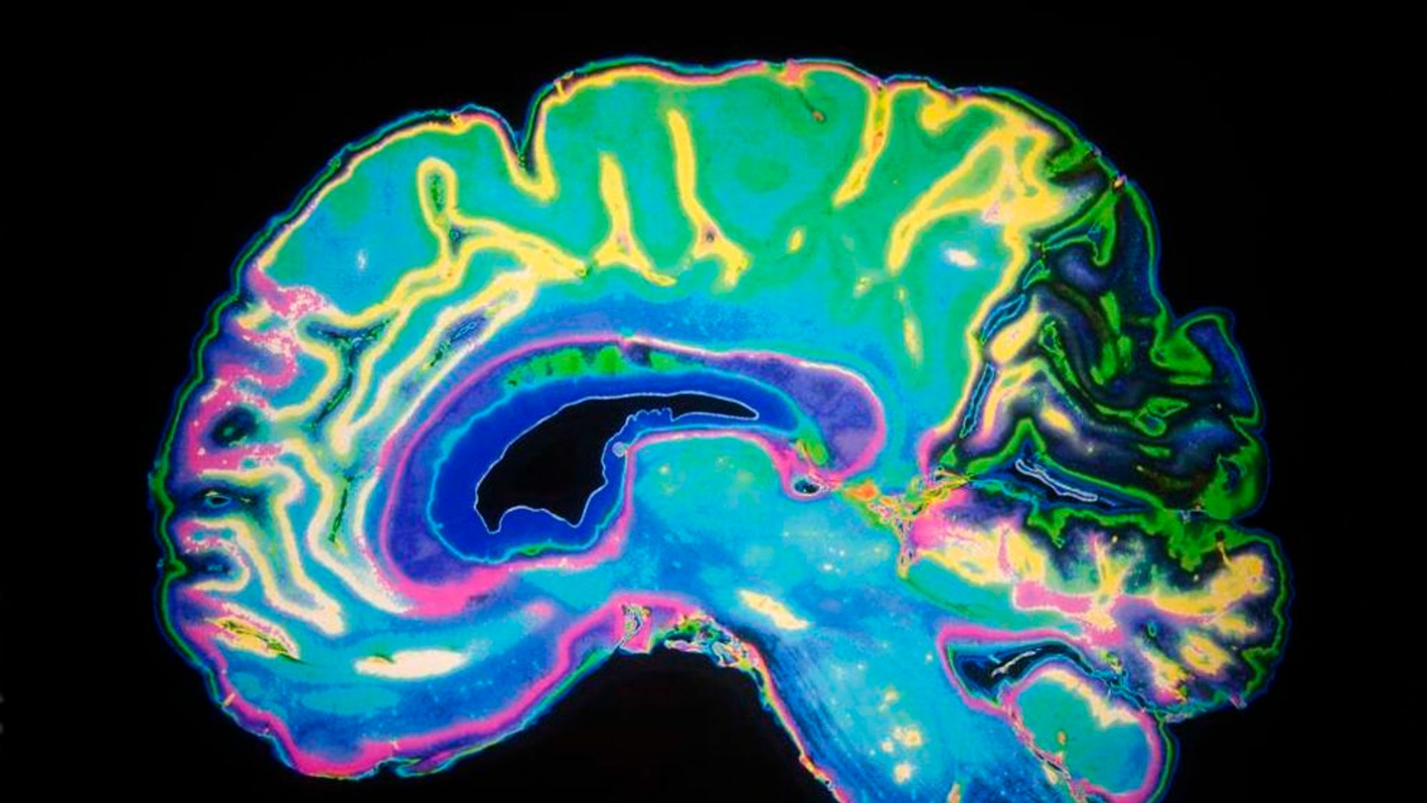 Moody and neurotic? It could be down to your brain shape | World News ...