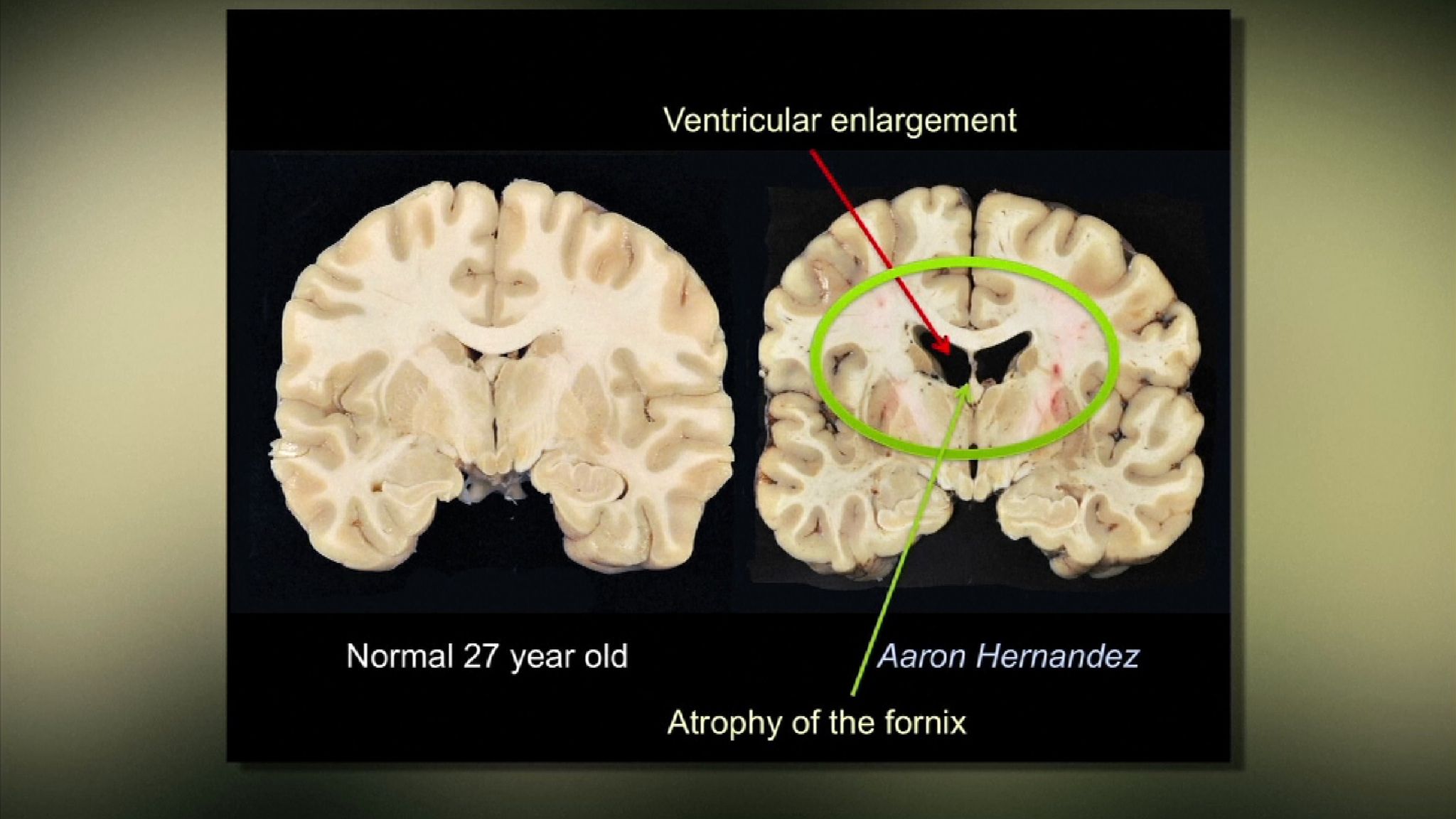 Aaron Hernandez's brain disease 'undoubtedly took years to develop ...