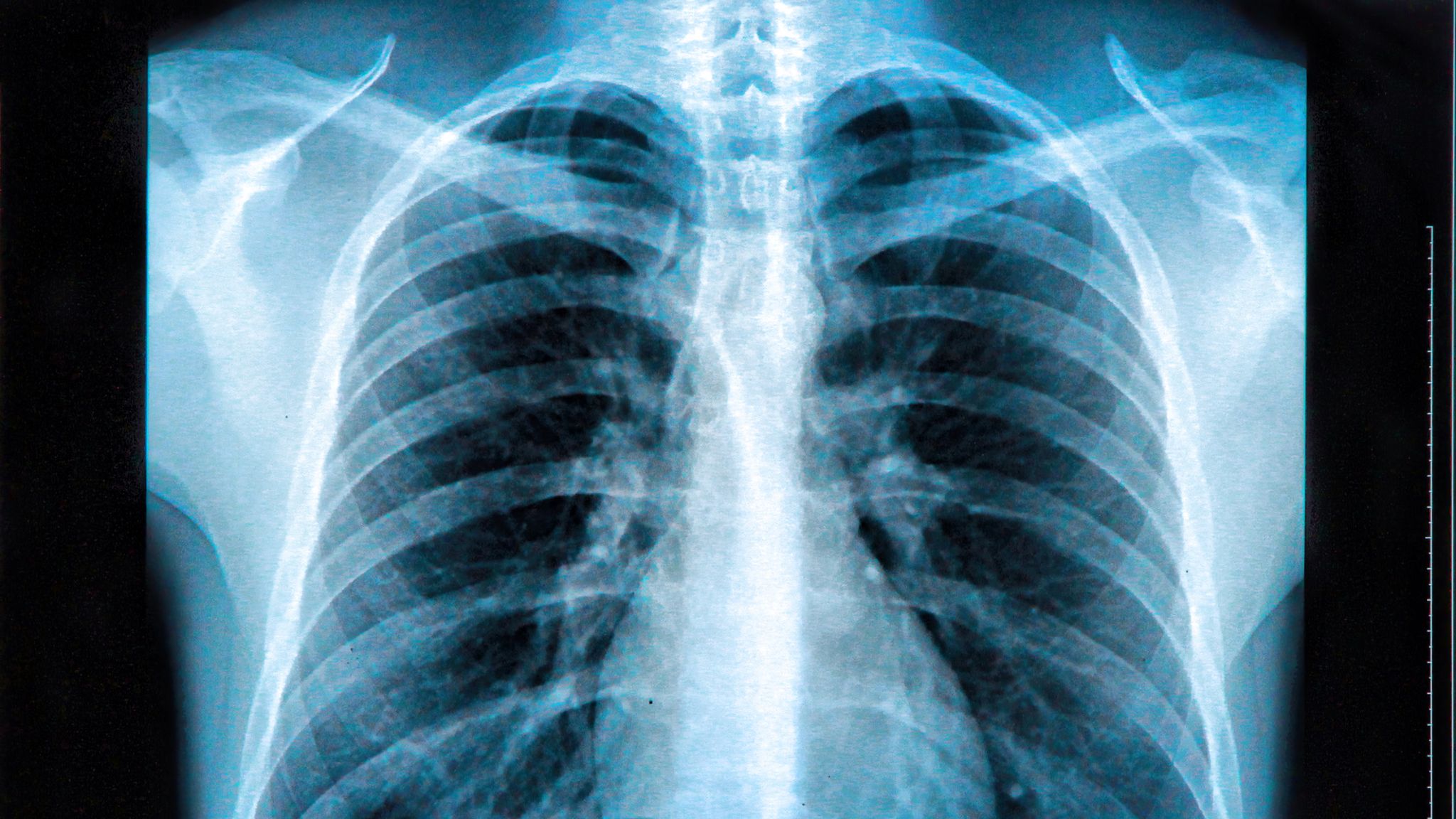 Cancer cases missed as junior doctors left to read x-rays at Portsmouth ...