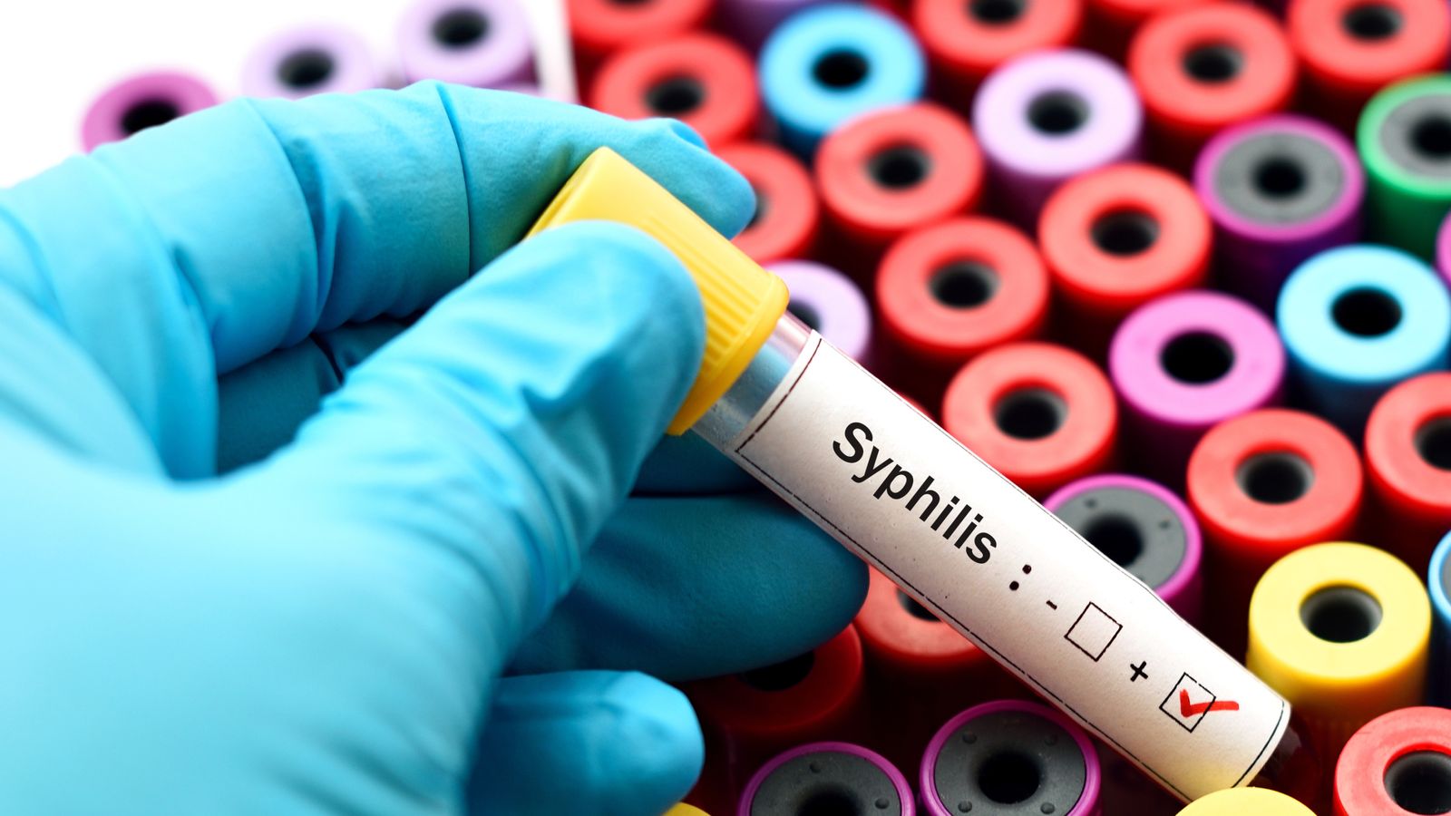 Highest surge in syphilis for nearly 70 years 'due to government cuts ...