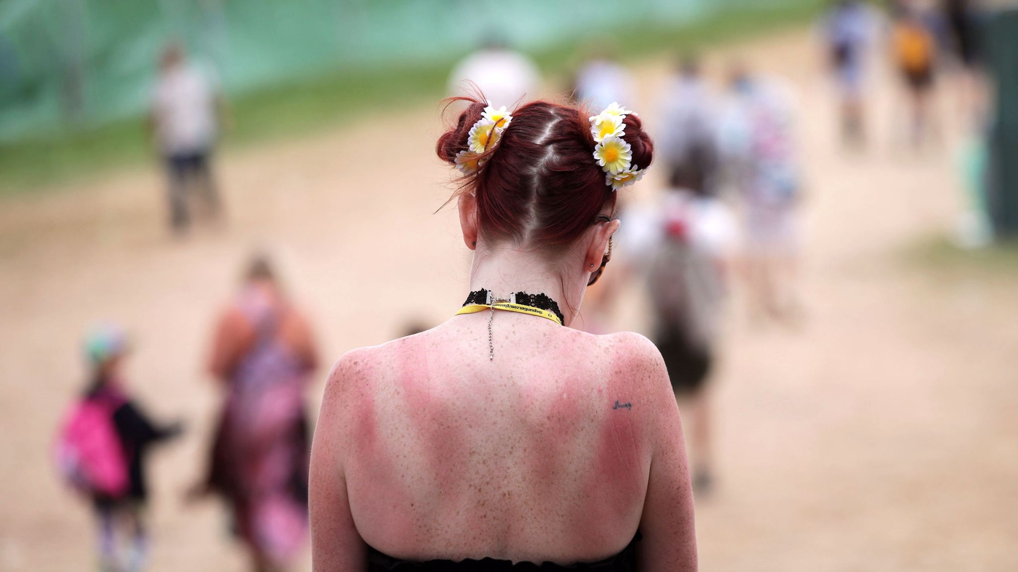 UK heatwave: How to treat sunburn, heat stroke and dehydration | UK ...