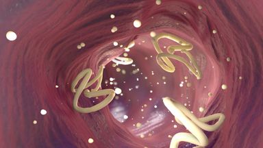 Man, 18, dies from tapeworm larvae in his brain after eating pork ...