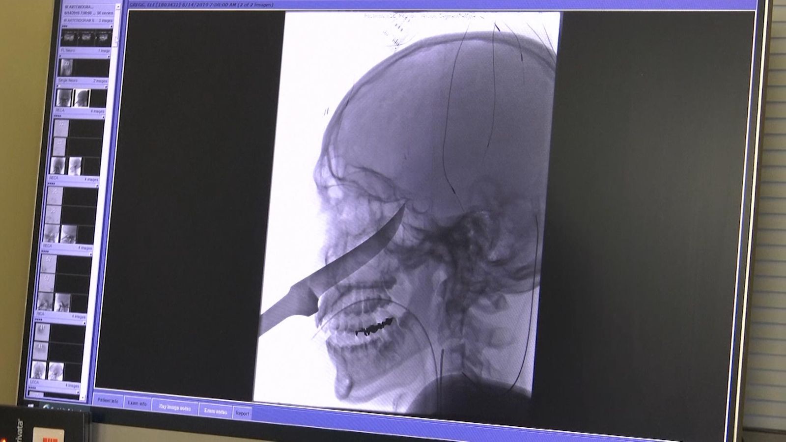 Teenager survives after 10in blade narrowly misses his brain | World ...