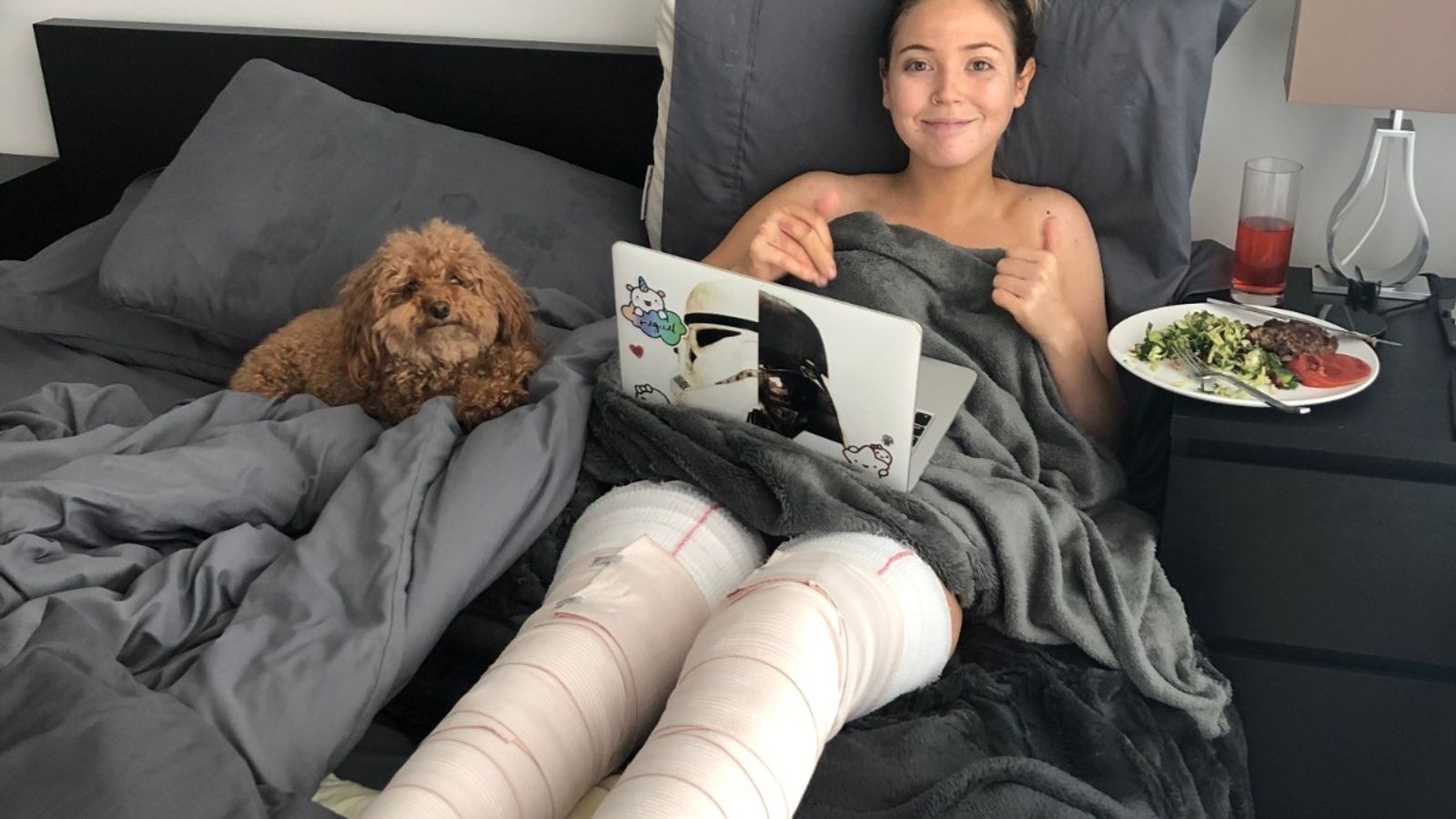 Model suffers horrific burns after photographer's 'reckless stunt ...