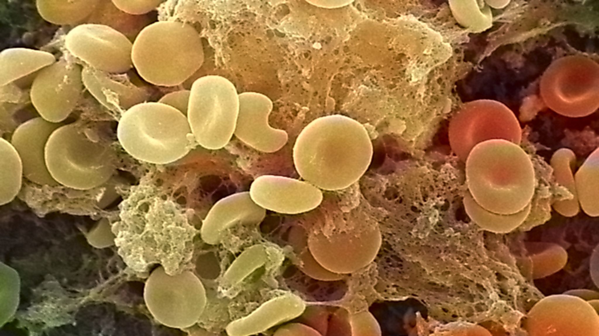 New method developed to understand malaria-related deaths | Science ...