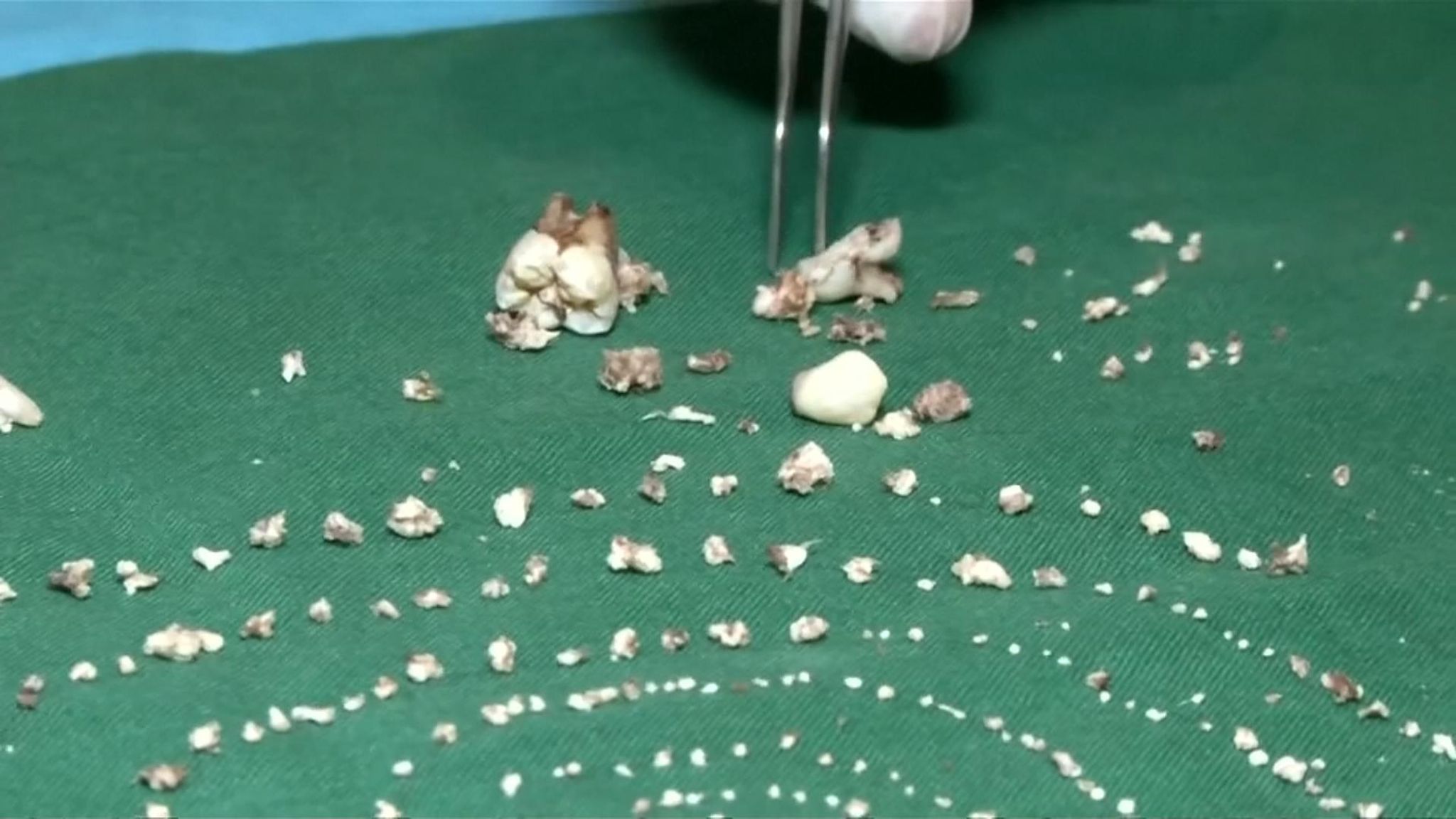 Child, 7, has 526 teeth removed from his mouth | World News | Sky News