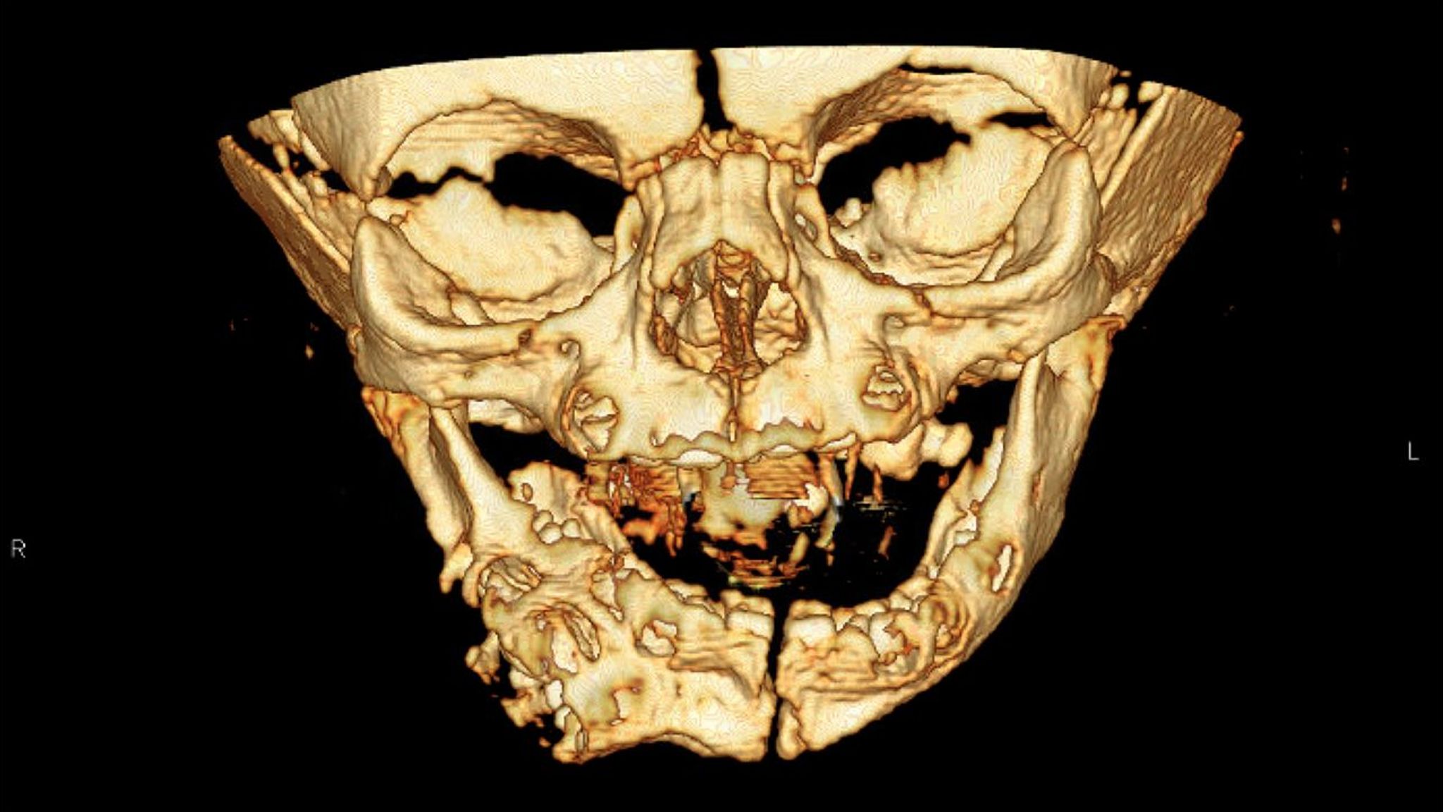 Baby born with two mouths due to 'extremely rare' condition | World ...