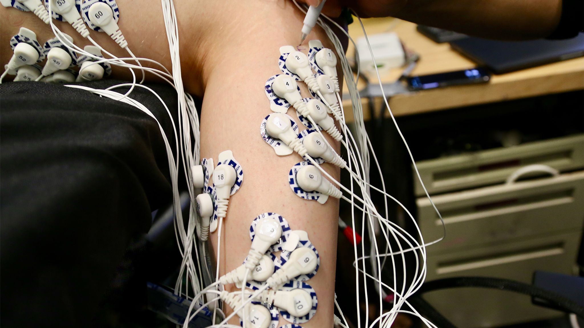 New amputation surgery could leave patients with less pain and more ...