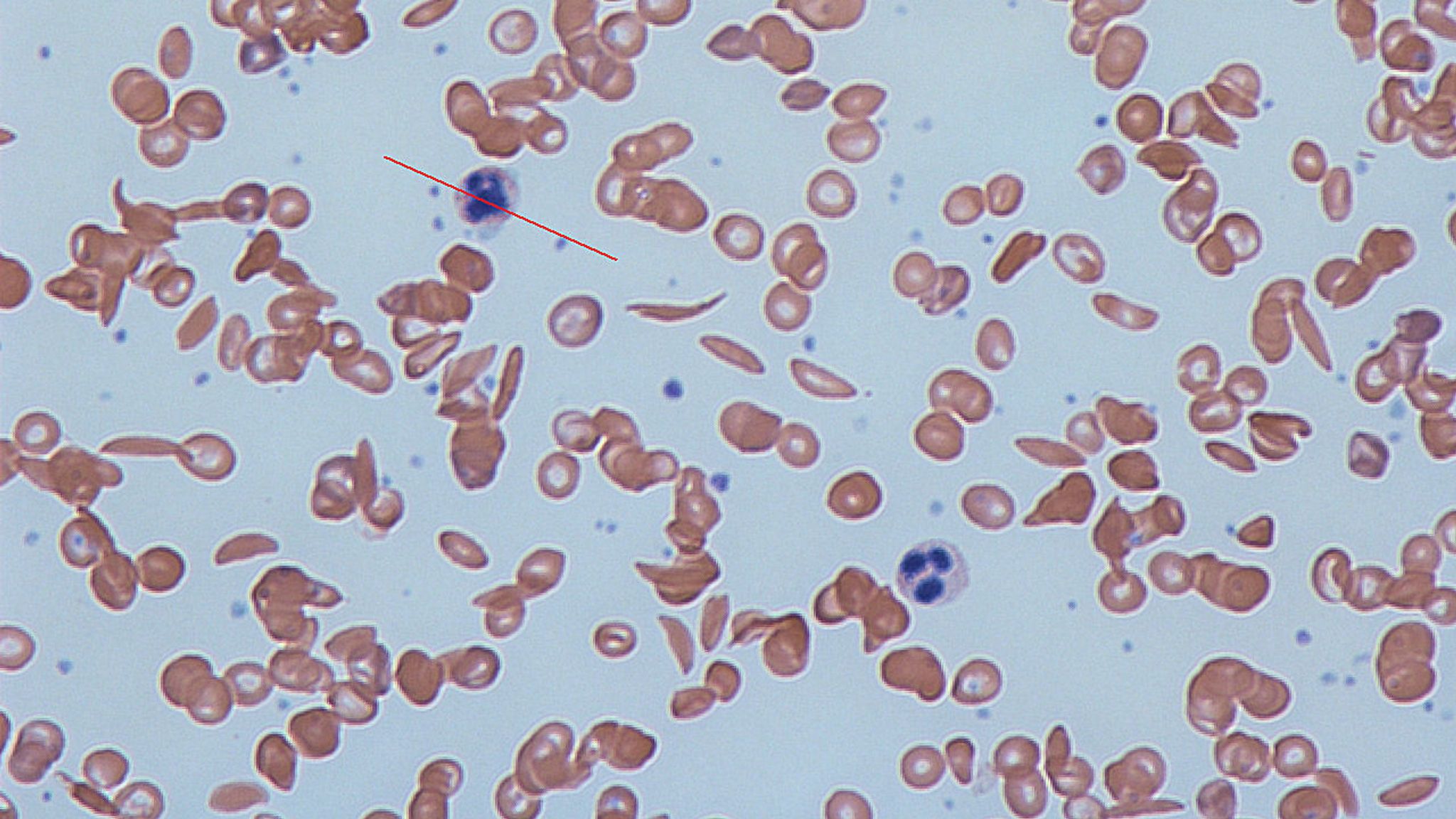 'Life-changing' sickle cell disease treatment made available on NHS ...