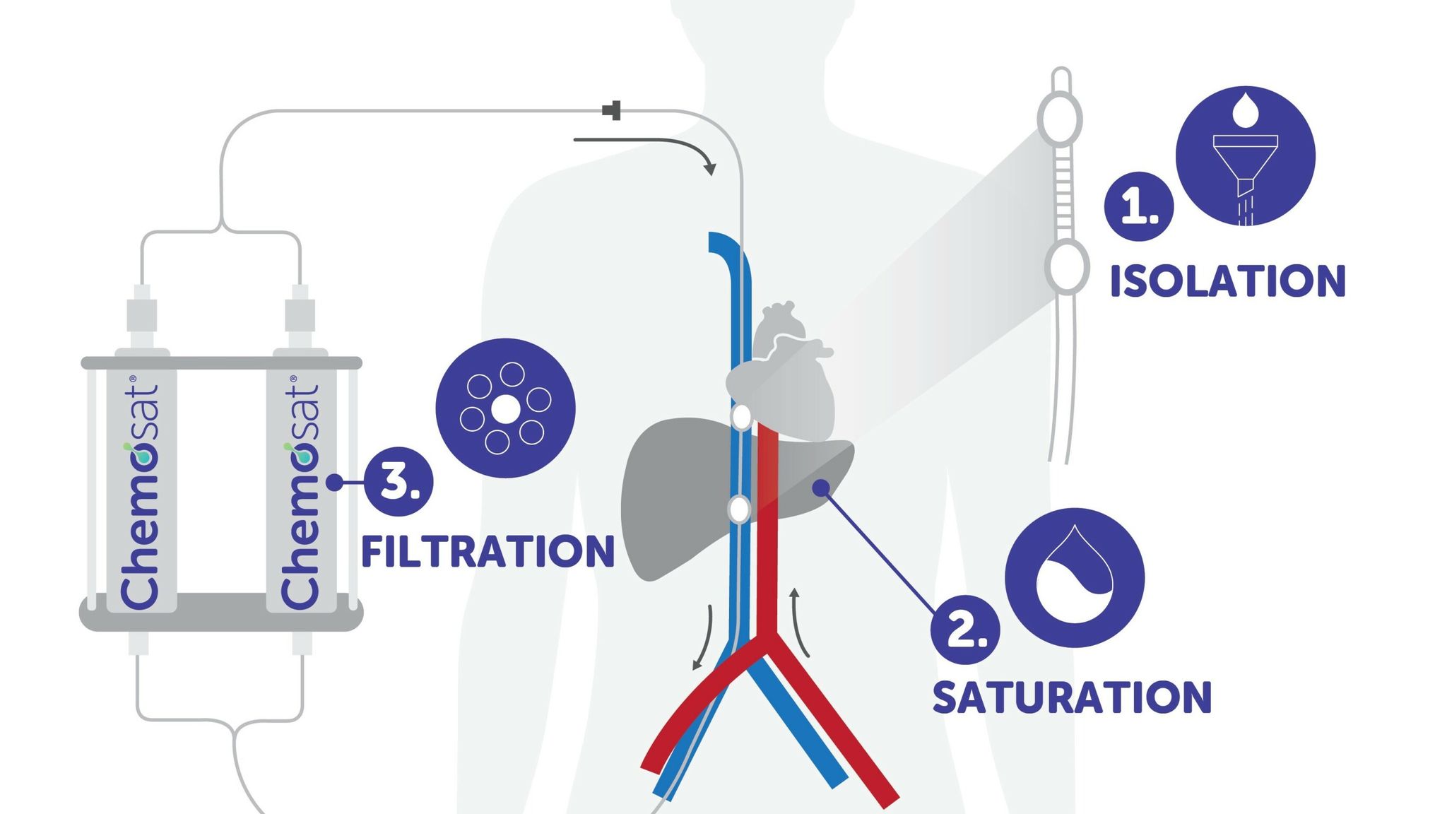 'Landmark' liver cancer treatment found to boost survival rate in ...