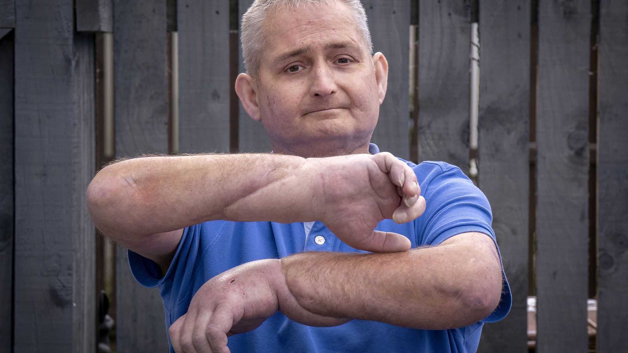Briton has double hand transplant in 'world's first' for scleroderma ...