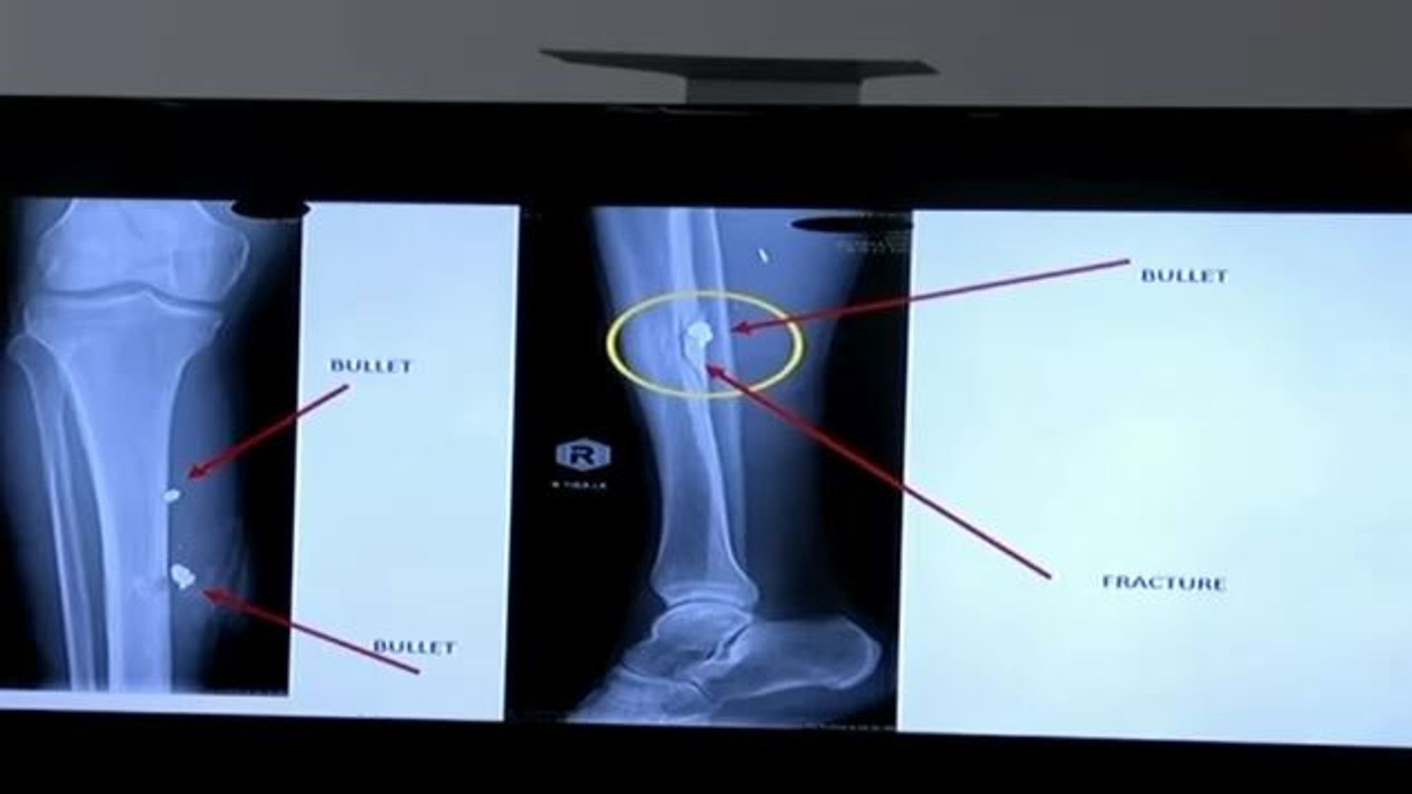 Imran Khan Former Pakistan Pm Says He Was Shot Four Times As He Reveals Extent Of Injuries