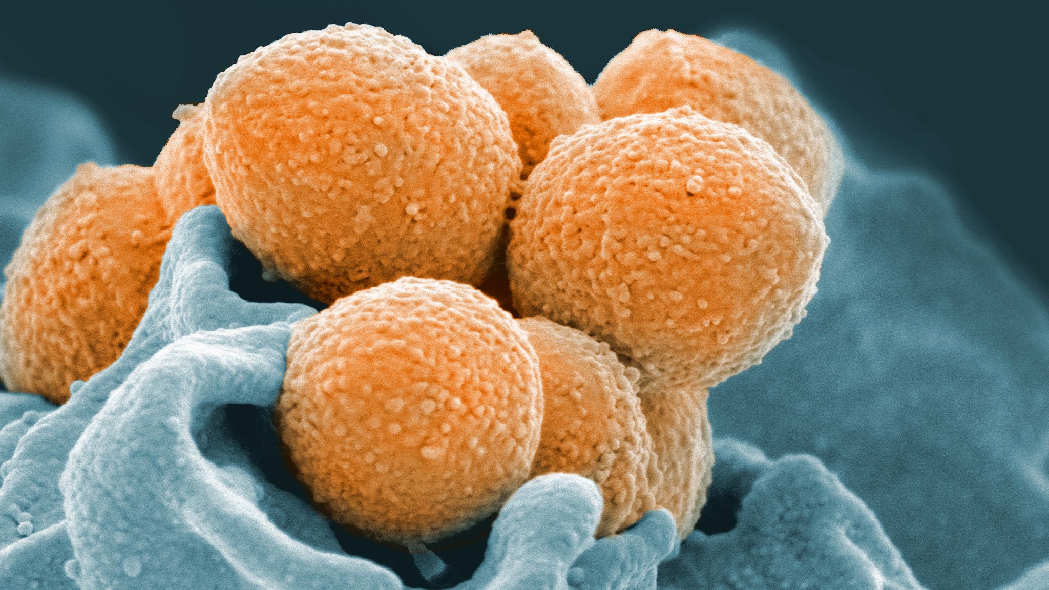 What Is Strep A And What Are The Symptoms Of The Bacterial Infection What Is Strep A And What Are The Symptoms Of The Bacterial Infection