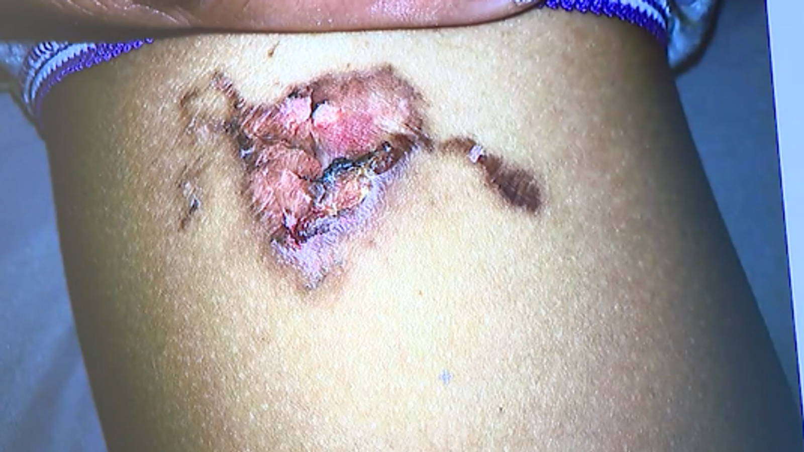 Florida girl badly burned by McDonald's Chicken McNugget gets $800,000 ...