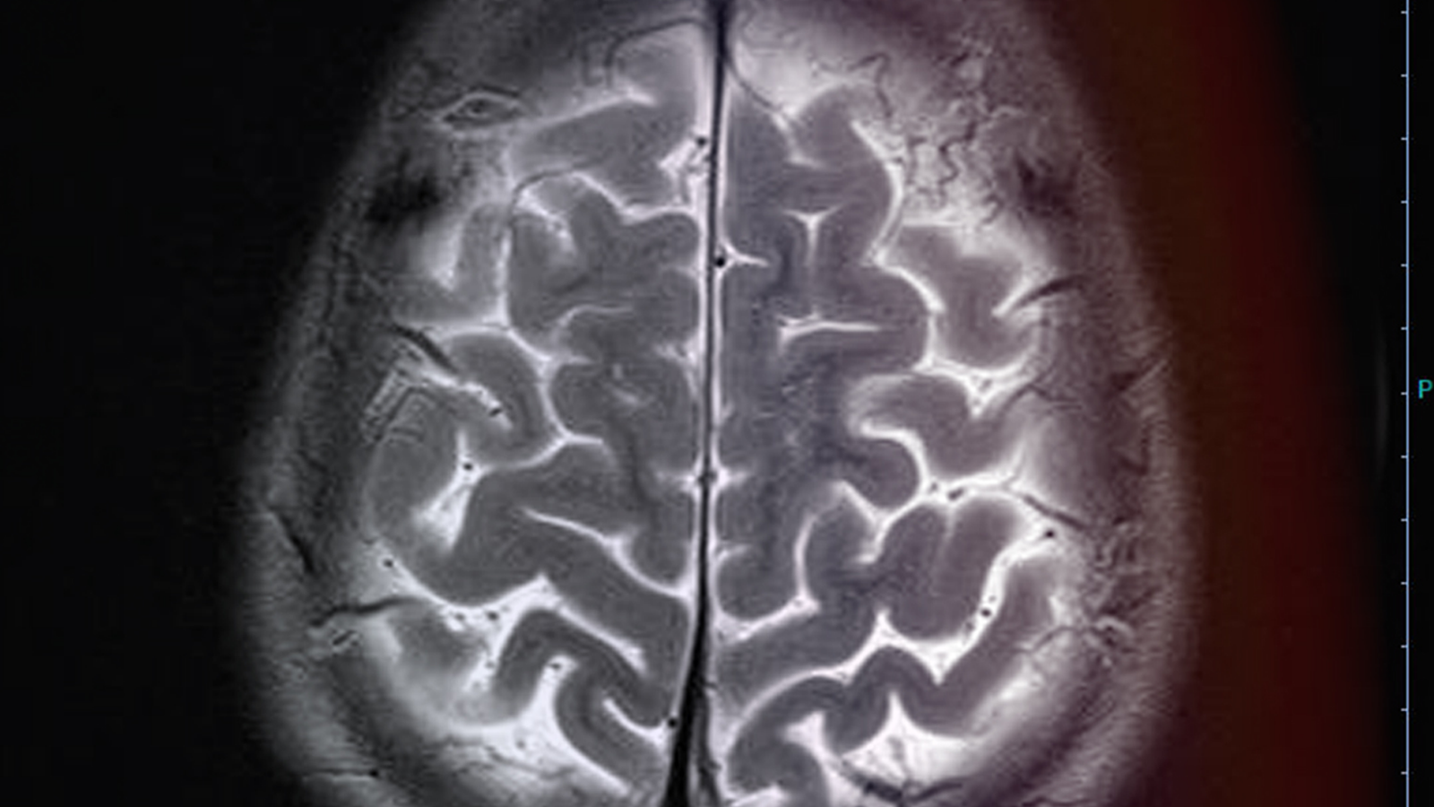 VC Pines: Soundtracking an epileptic brain - one musician's story of ...