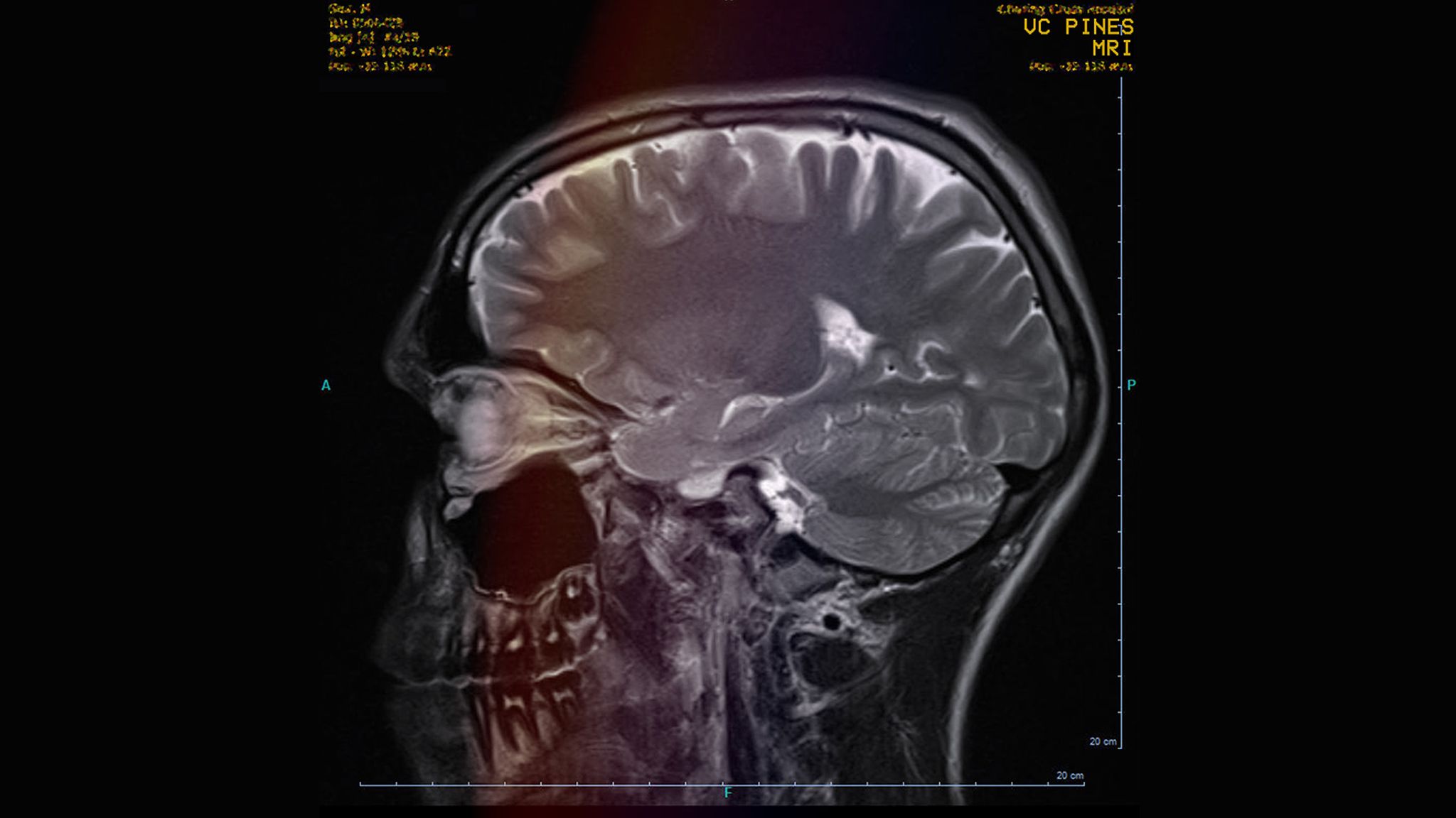 VC Pines: Soundtracking an epileptic brain - one musician's story of ...