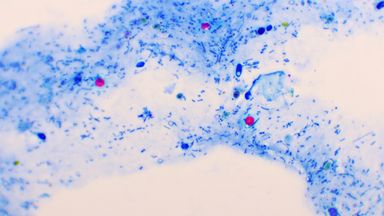 'Unprecedented' rise in people infected with diarrhoea-causing parasite ...