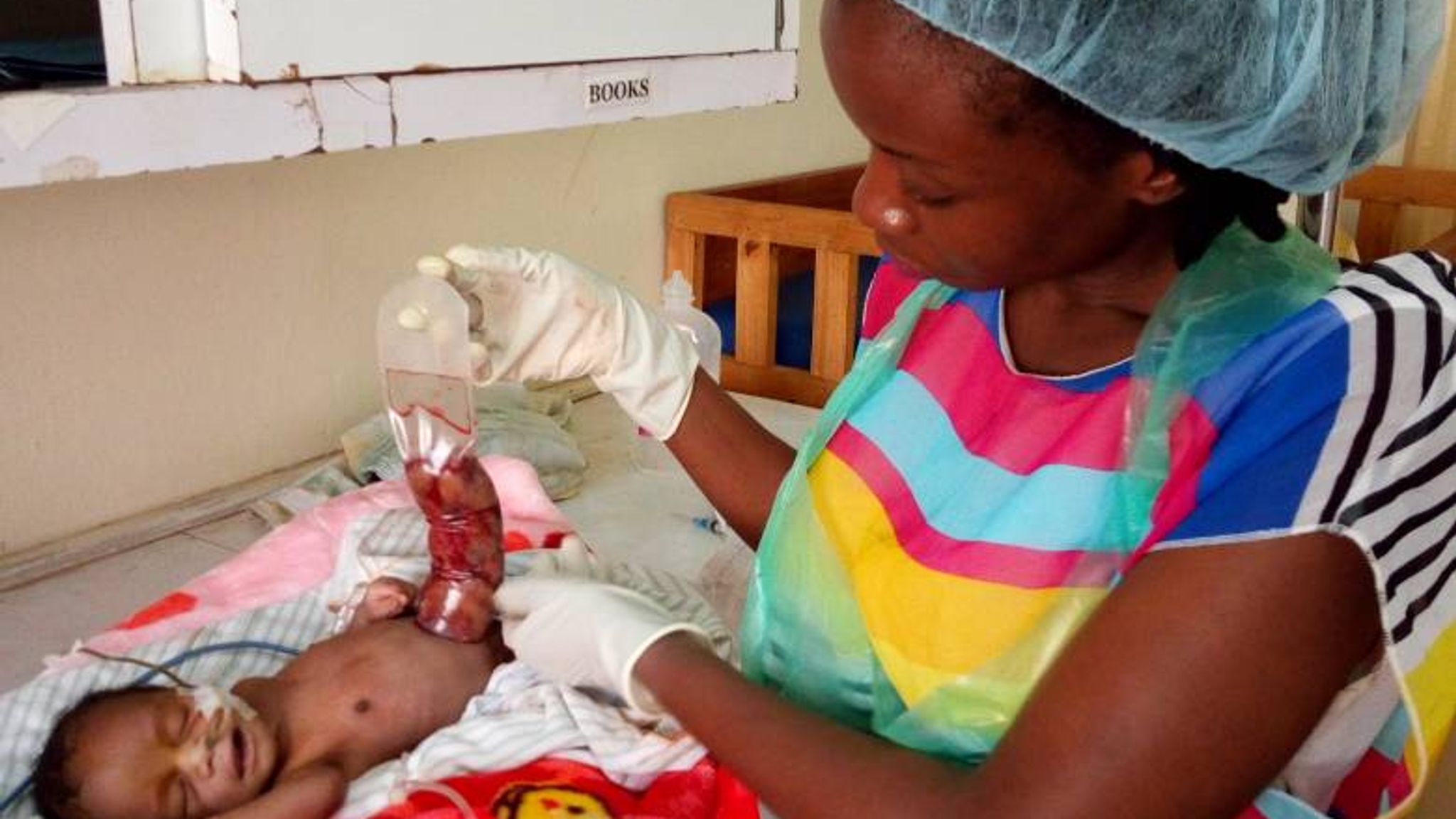 Mysterious rise in babies born in East Africa with 'guts on the outside ...
