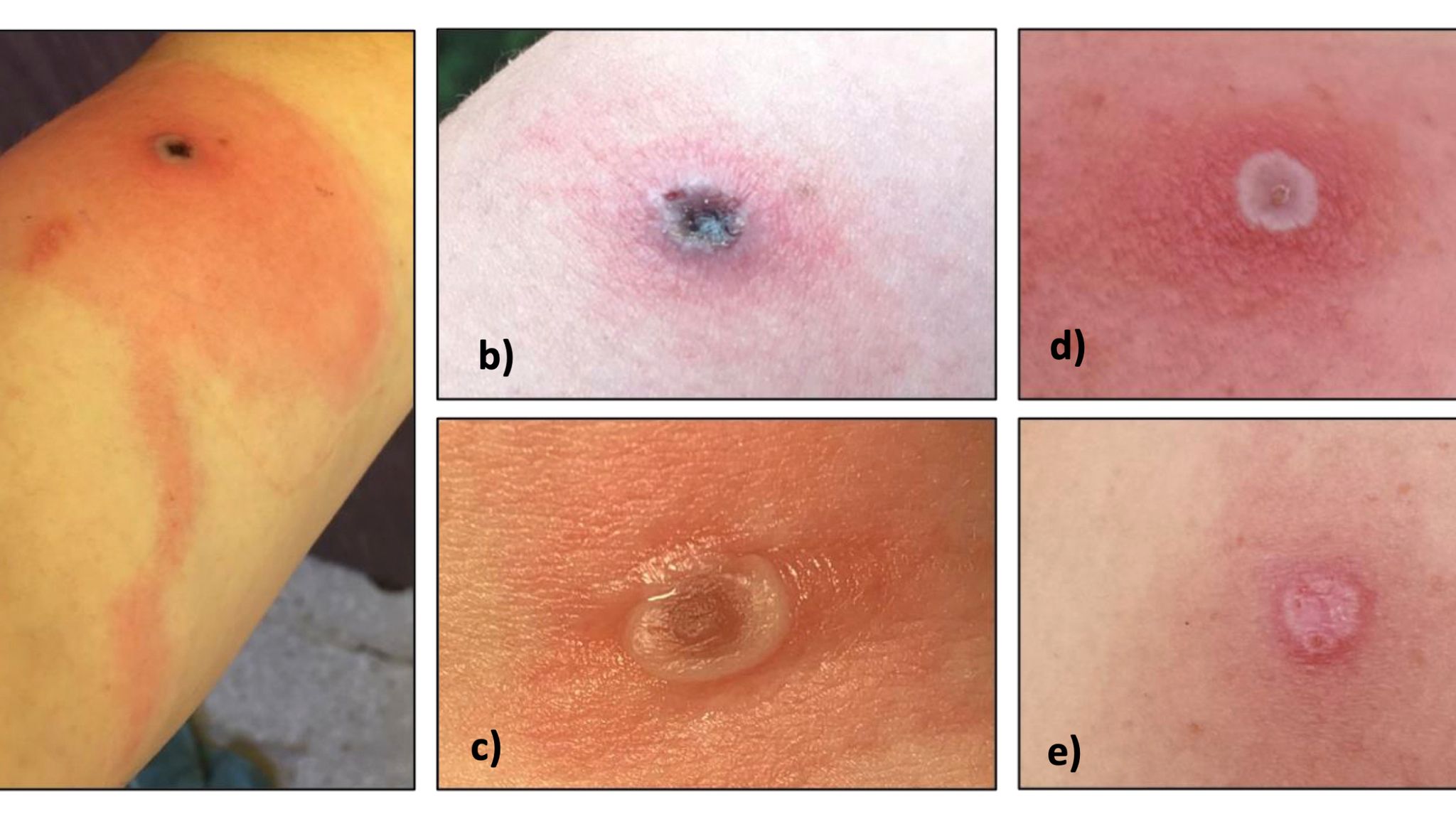Alaskapox: What is the viral disease that killed an elderly man? | US ...