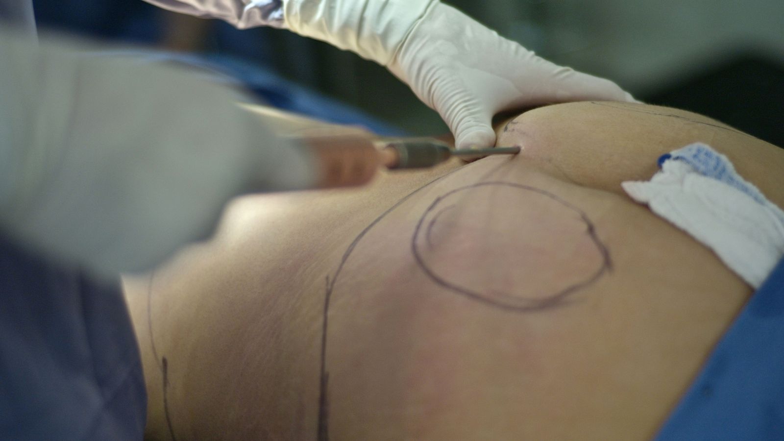 Edinburgh council urges residents going to BBL surgeries offered online ...