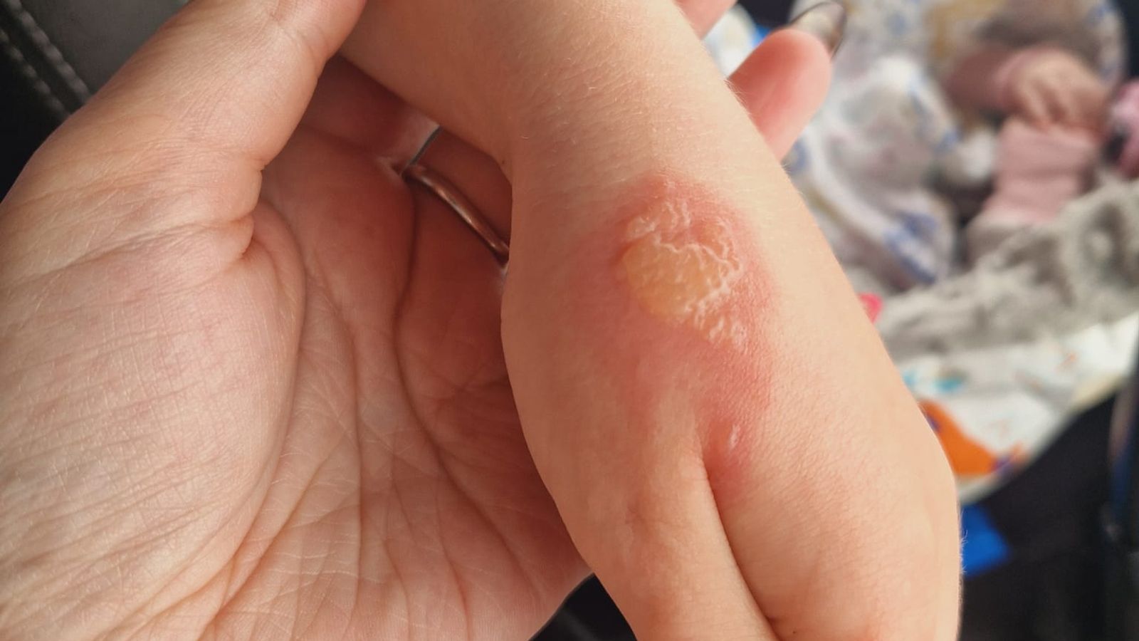 Boy, 8, 'scarred for life' after toxic giant hogweed plant causes ...