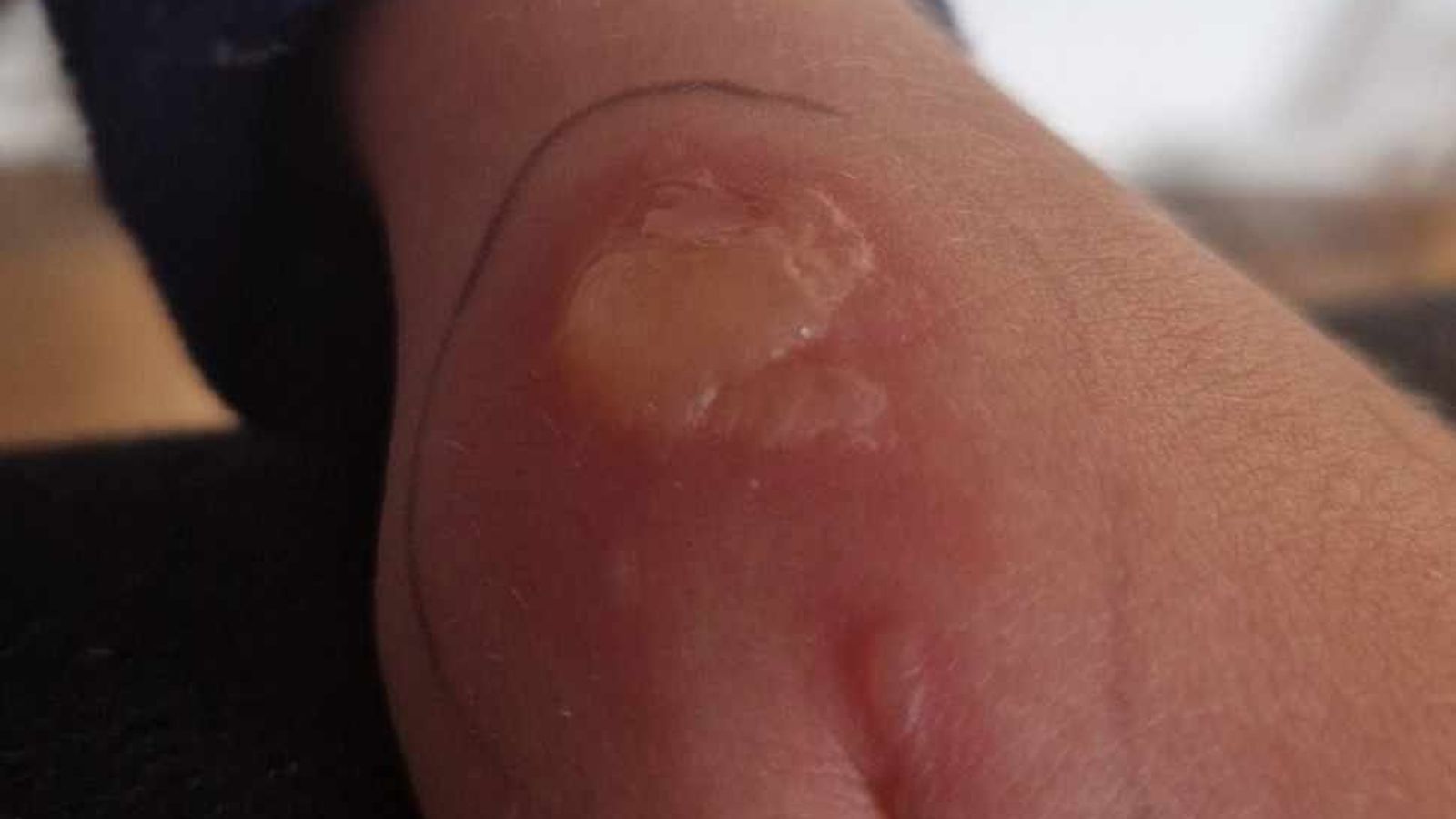 Boy, 8, 'scarred for life' after toxic giant hogweed plant causes ...