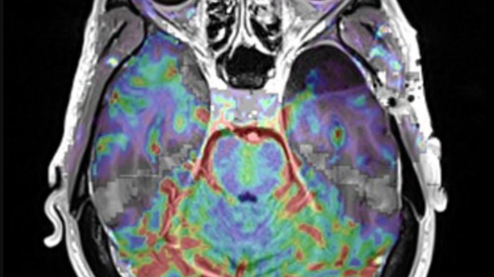 Doctor still cancer-free almost a year after incurable brain tumour ...