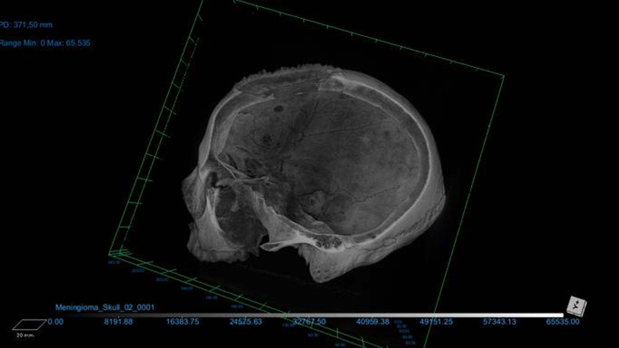 Ancient Egyptians performed cancer surgery, 'extraordinary' new ...