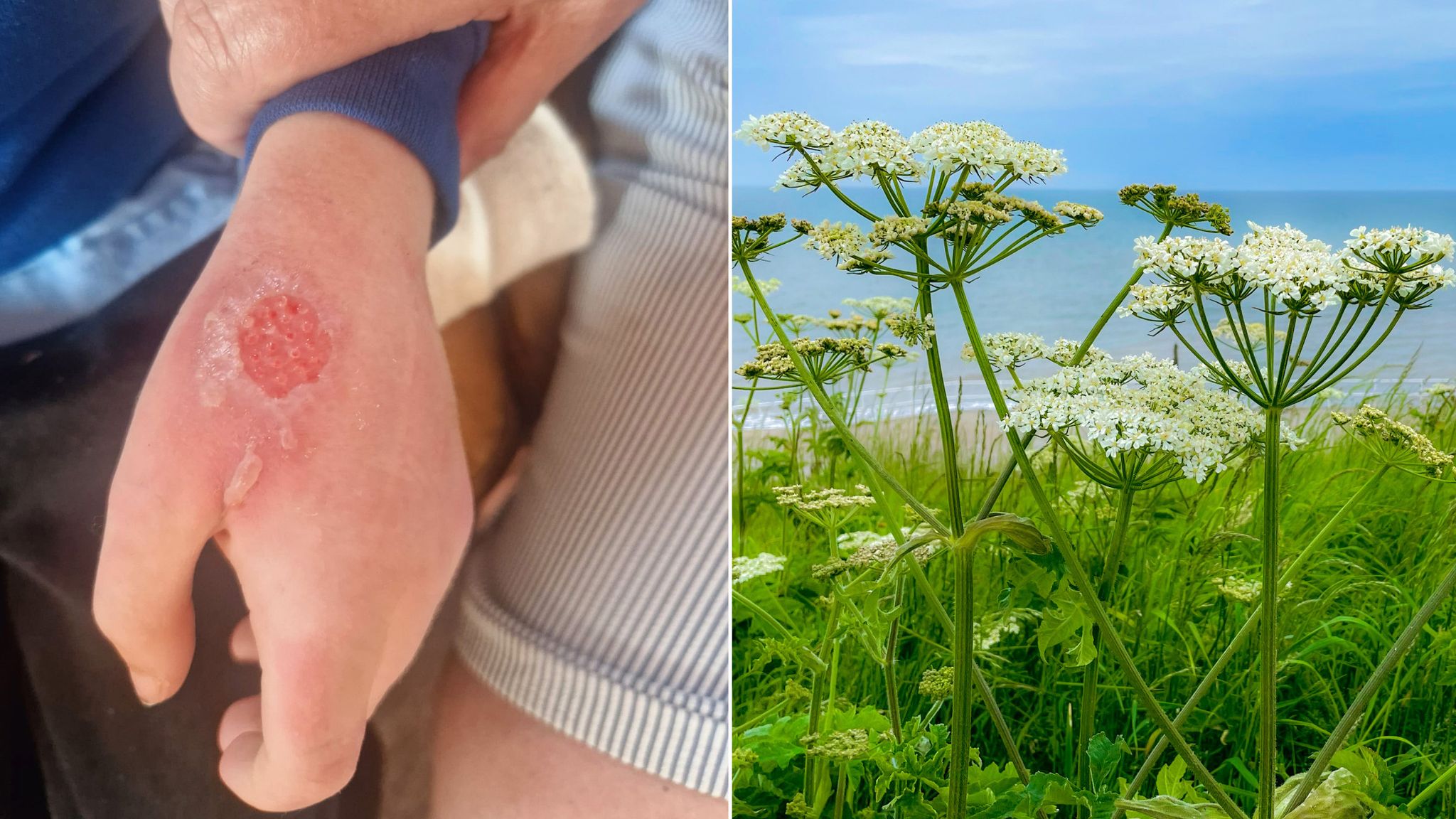 Giant Hogweed Blisters GIANT HOGWEED BURNS Wise Property Care