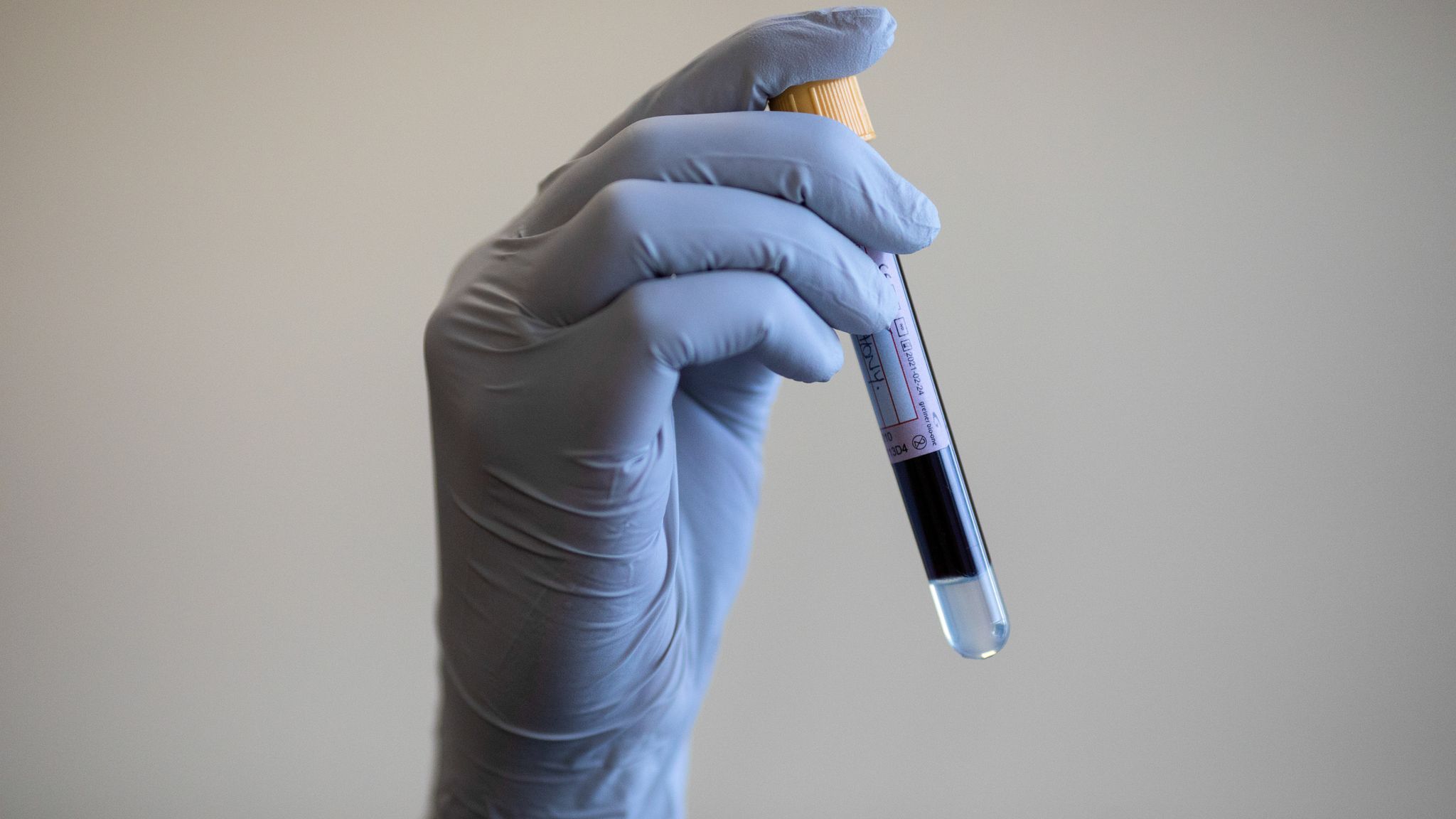 Blood test that can detect 12 common cancers to be trialled on NHS ...