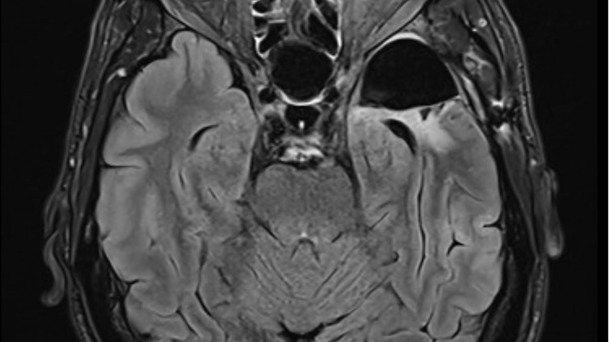 Doctor still cancer-free almost a year after incurable brain tumour ... Doctor still cancer-free almost a year after incurable brain tumour ...
