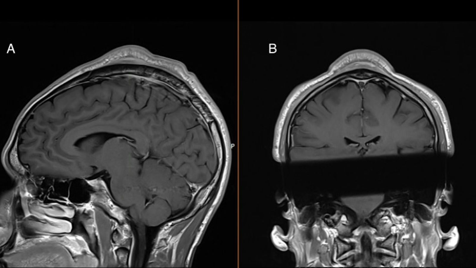 Breakdancers warned repetitive headspins could give them a 'cone-head ...