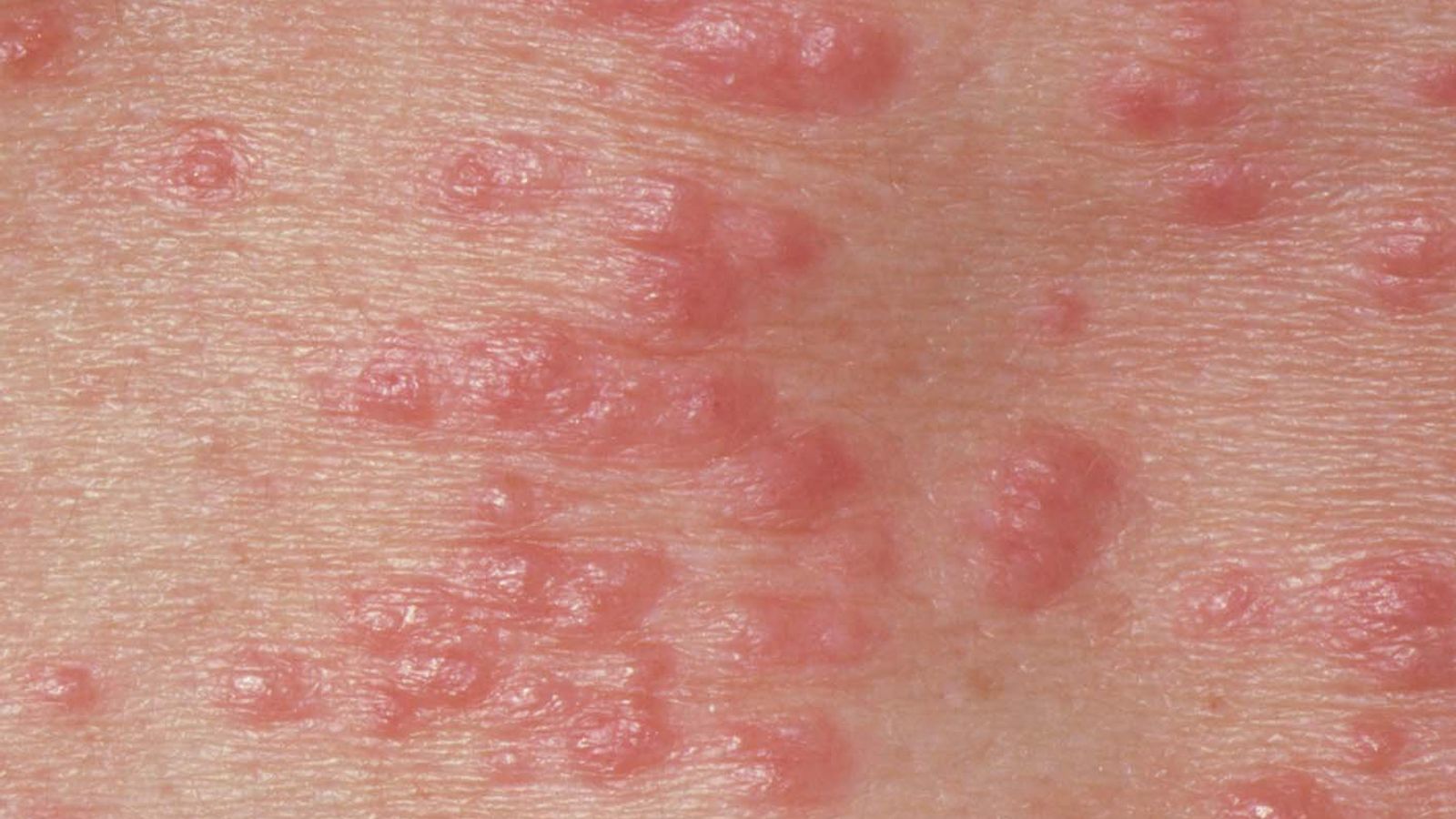 Scabies cases rise in England as GPs urge people not to ignore ...