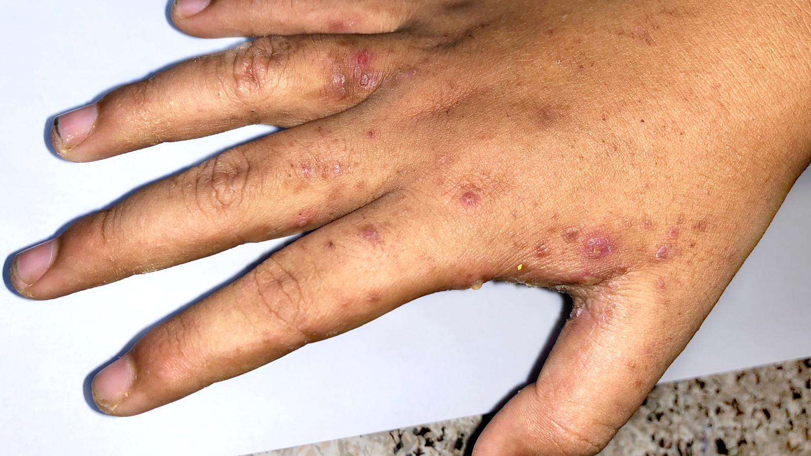 Scabies cases rise in England as GPs urge people not to ignore ...