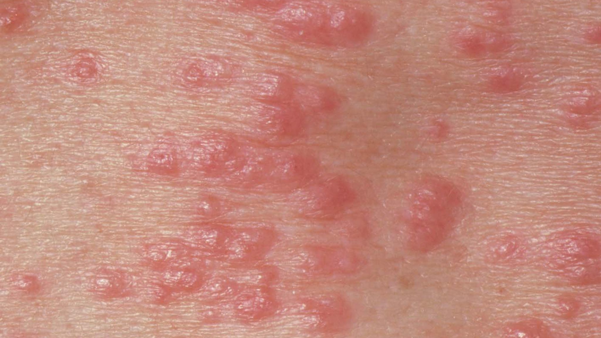 Scabies Cases Rise In England As Gps Urge People Not To Ignore