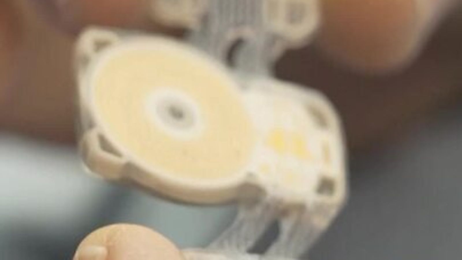 UCLH implanted the first two patients in the UK with a small chip under ...