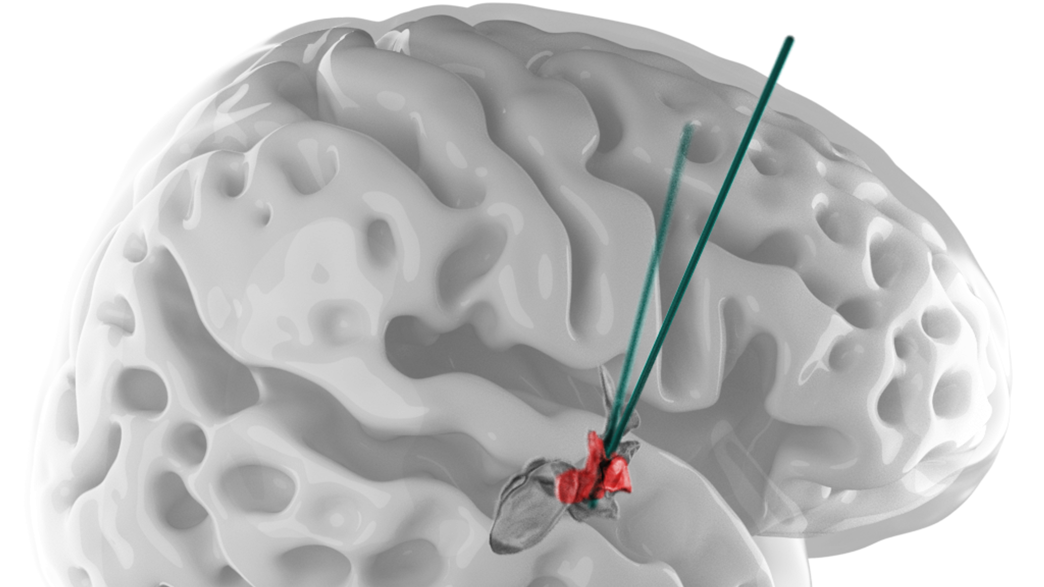 Paralysed patients able to walk short distances after having electrodes ...