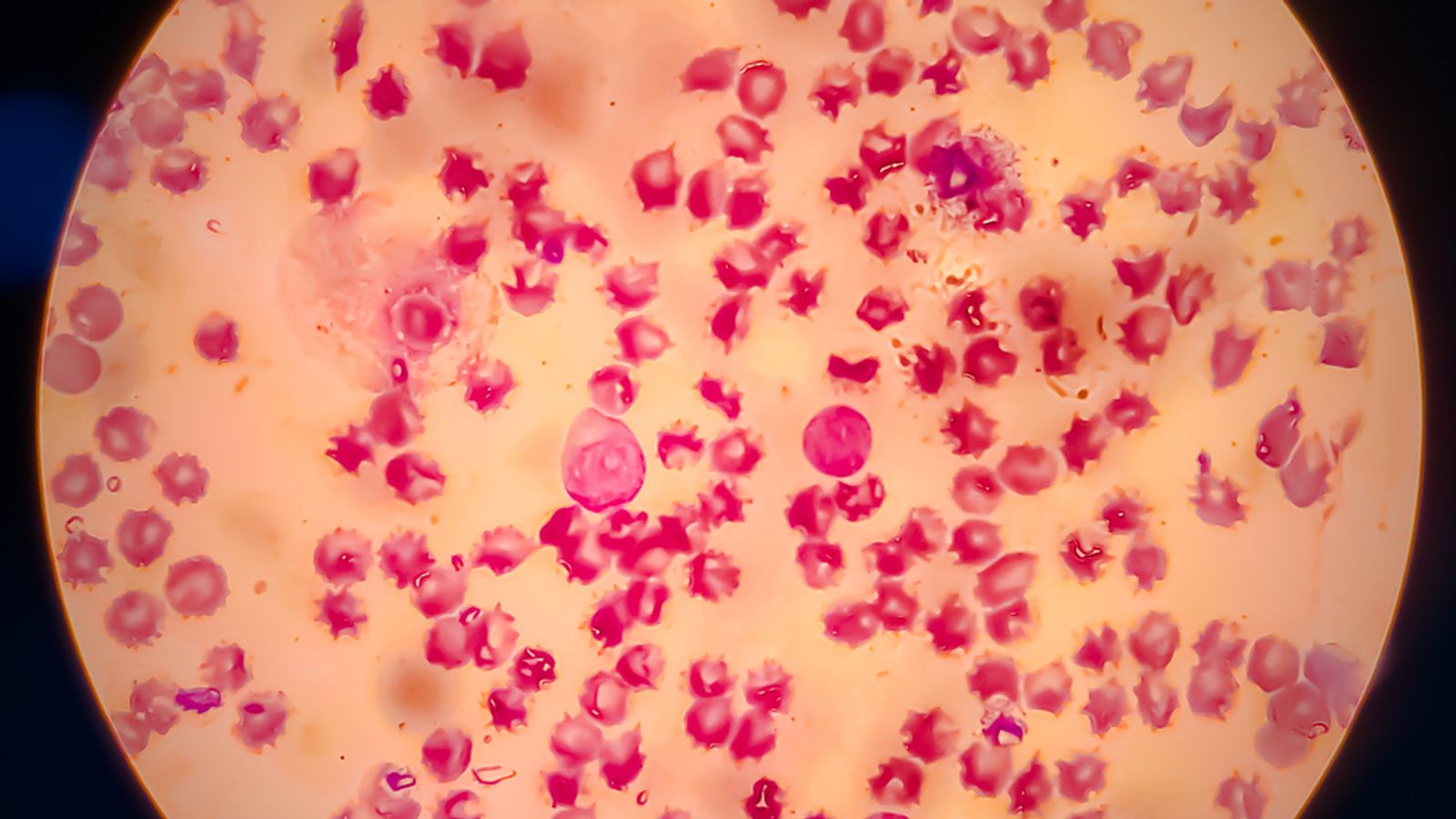 'Groundbreaking' sickle cell treatment to be offered to NHS patients ...