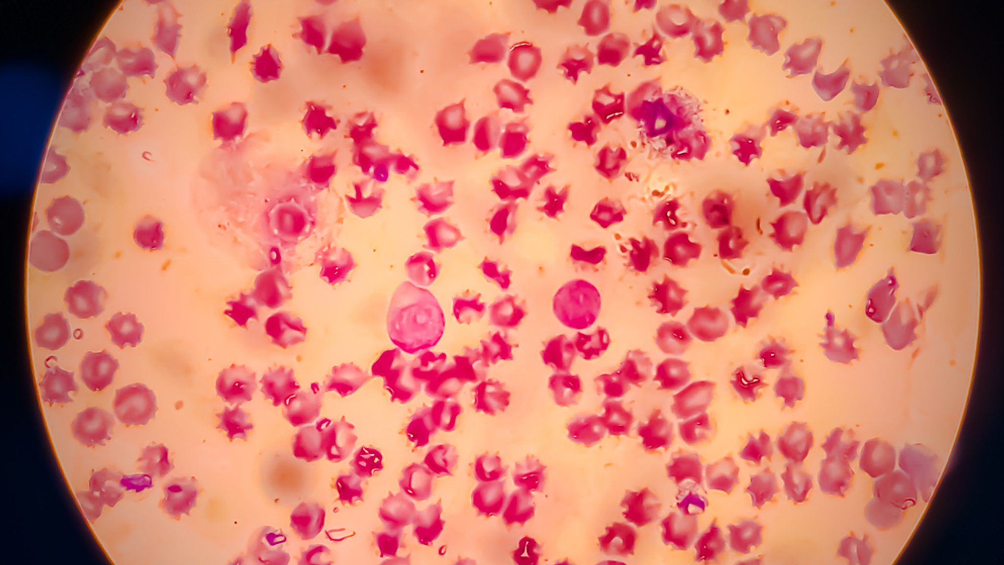 'Groundbreaking' sickle cell treatment to be offered to NHS patients ...