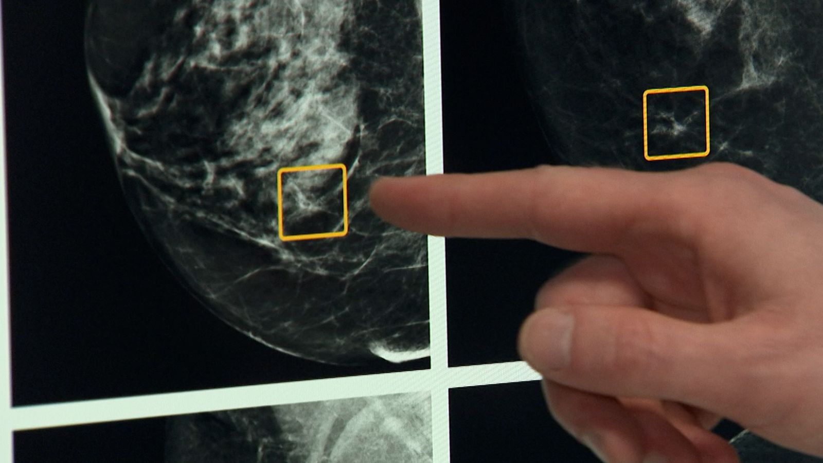 Major breast cancer screening AI trial launched | News UK Video News ...