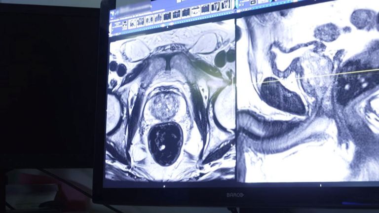 EU to start large-scale screening trial for prostate cancer | News UK ... EU to start large-scale screening trial for prostate cancer | News UK ...