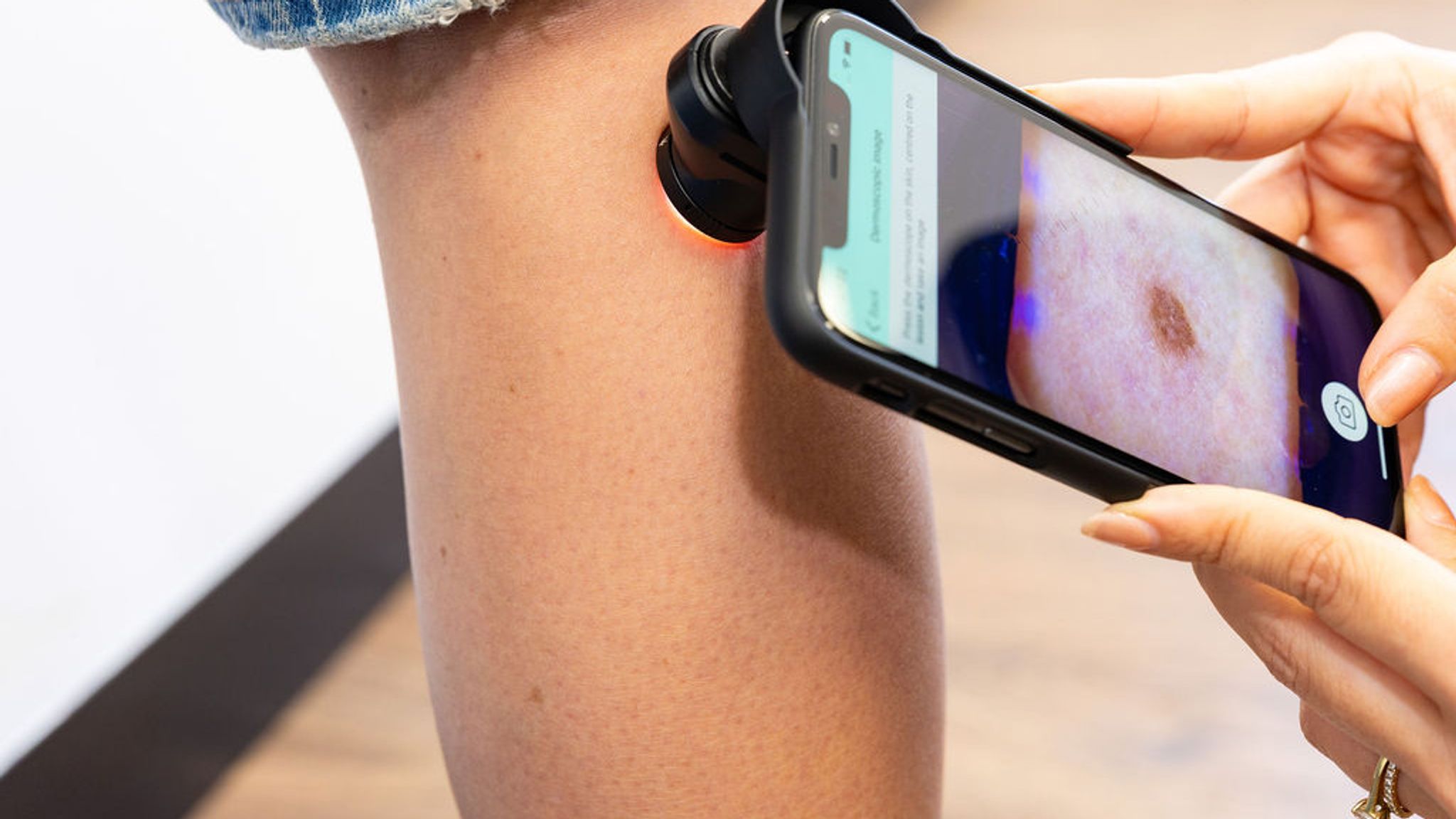 Skin cancer detection firm lands £15m to fund growth plans | Money News ...