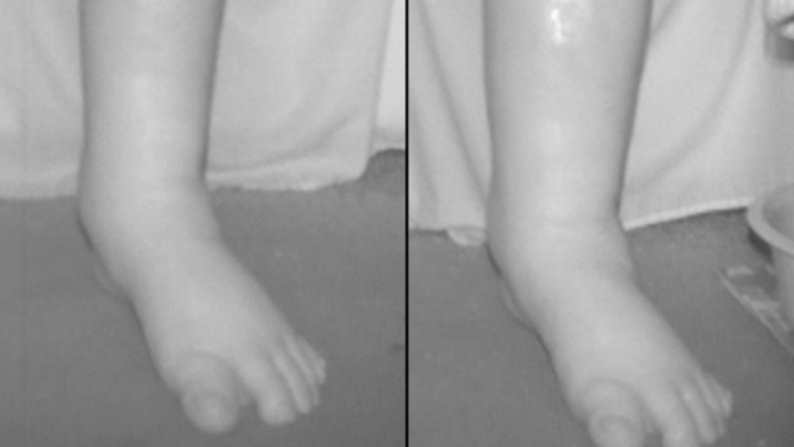 AI foot scanner recognises warning signs of heart failure to keep ...
